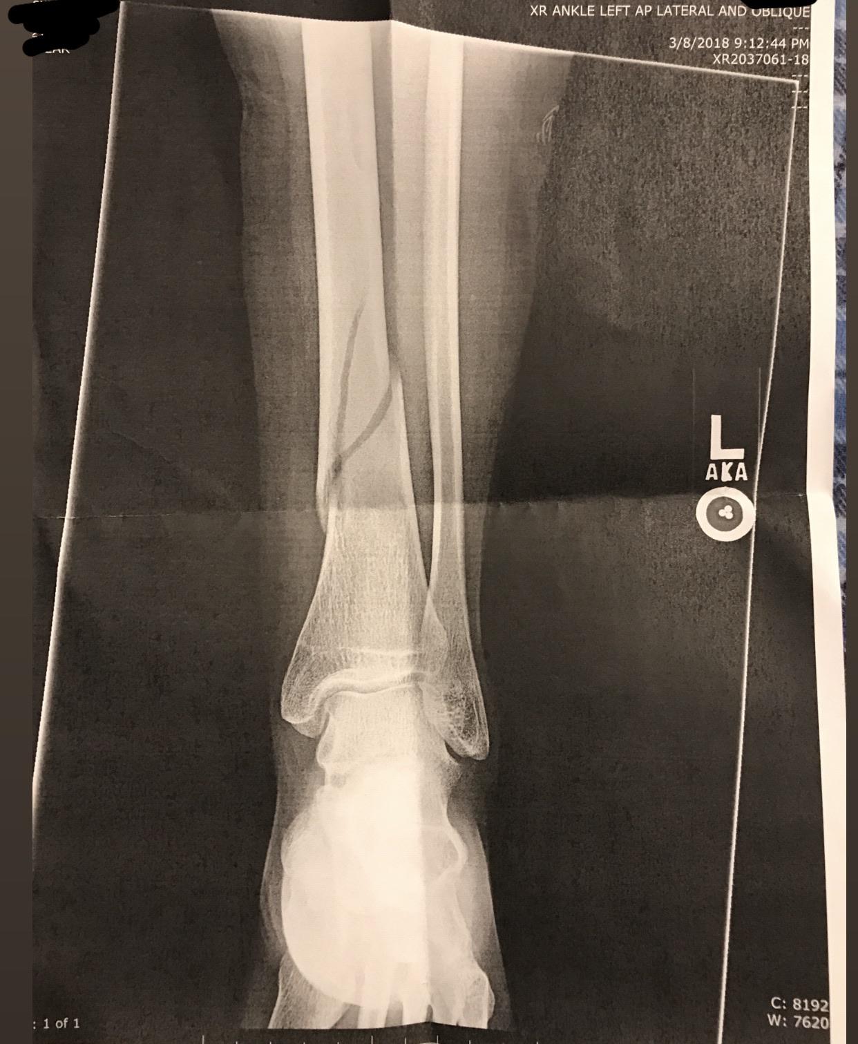 Spiral fracture from roller derby practice. Don’t even know what ...