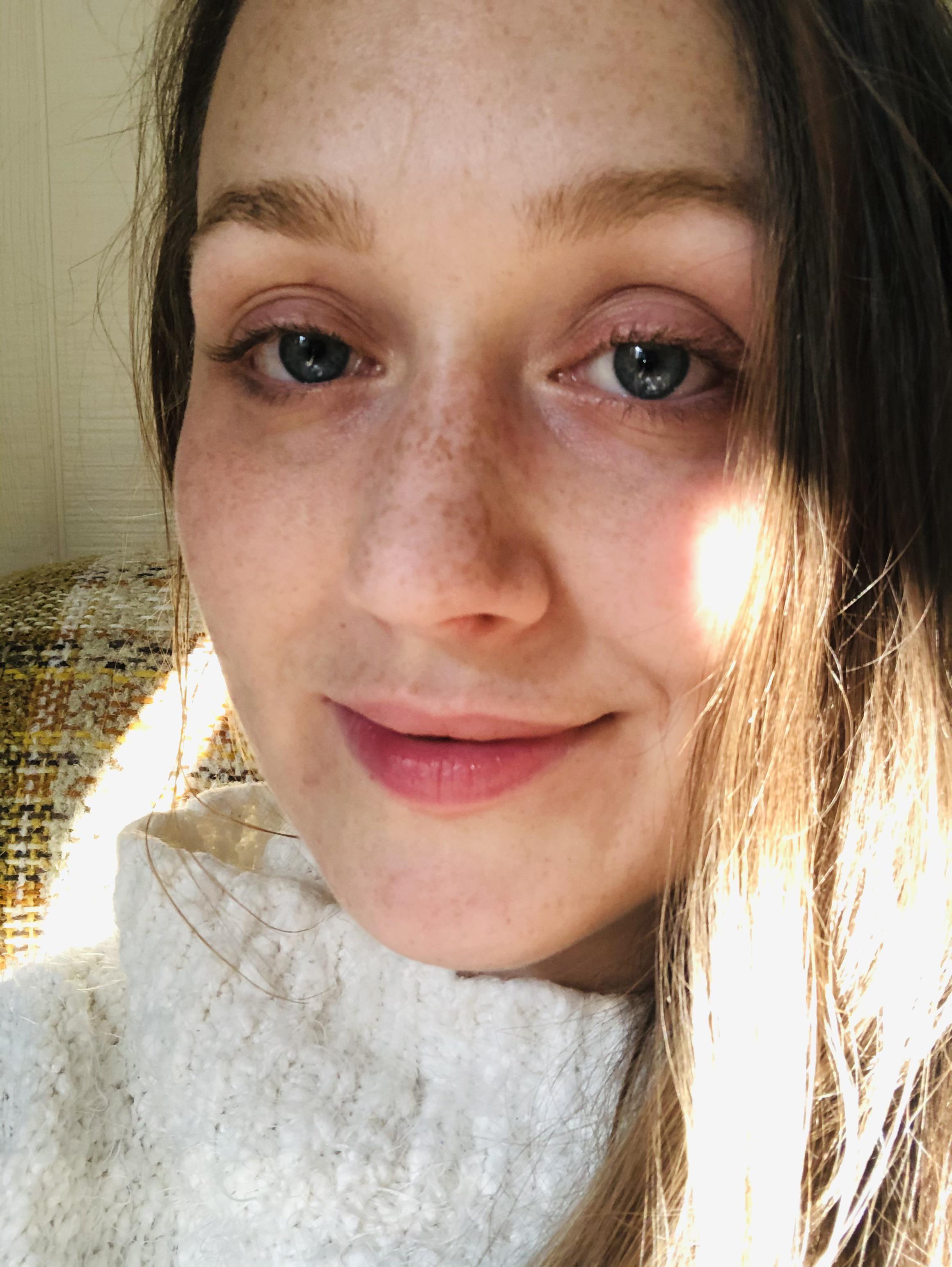 Springtime freckles coming out! | Scrolller