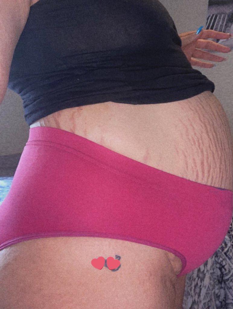 Stretch marks for days 💋 | Scrolller