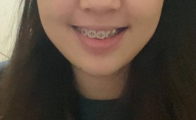 Teeth starting to slant after braces... Anyone with similar experiences? | Scrolller