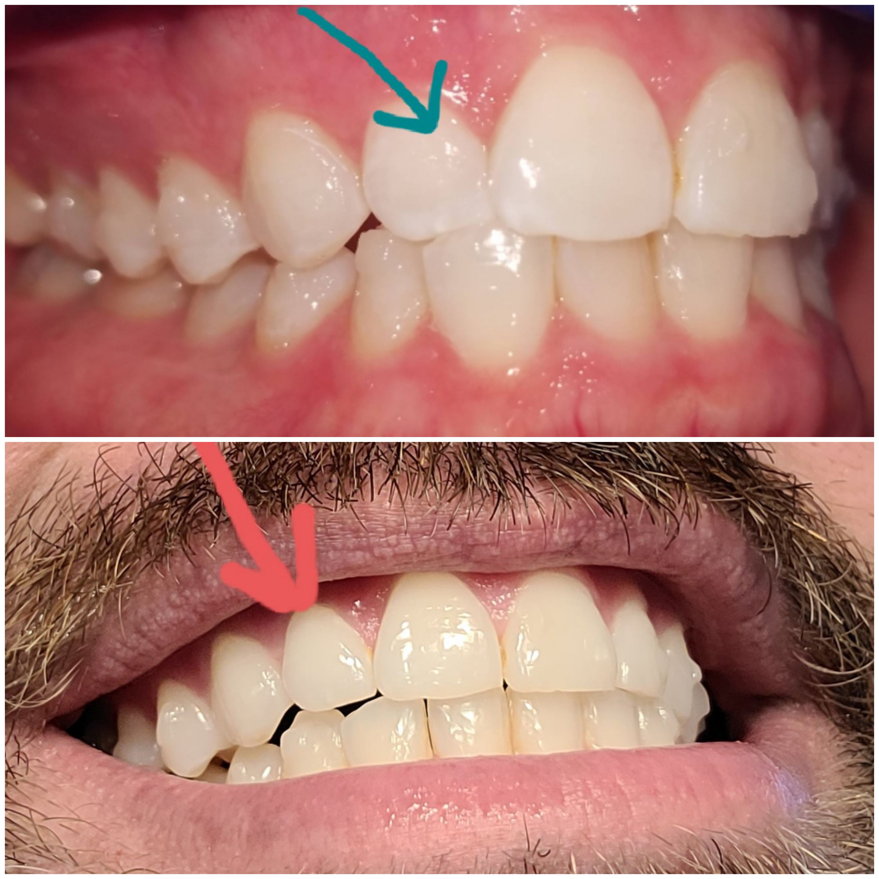 This top tooth used to be behind my bottom teeth. It's now finallyyyy moving into place! | Scrolller