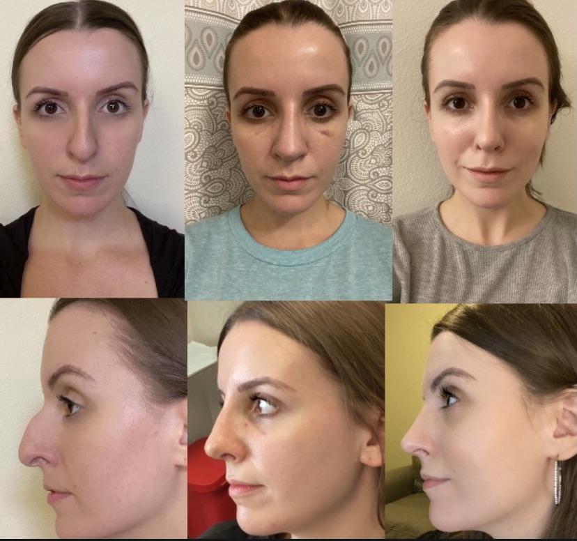 Updated: Rhinoplasty Progression (pre op, 1 week post op, 6 weeks post op) | Scrolller