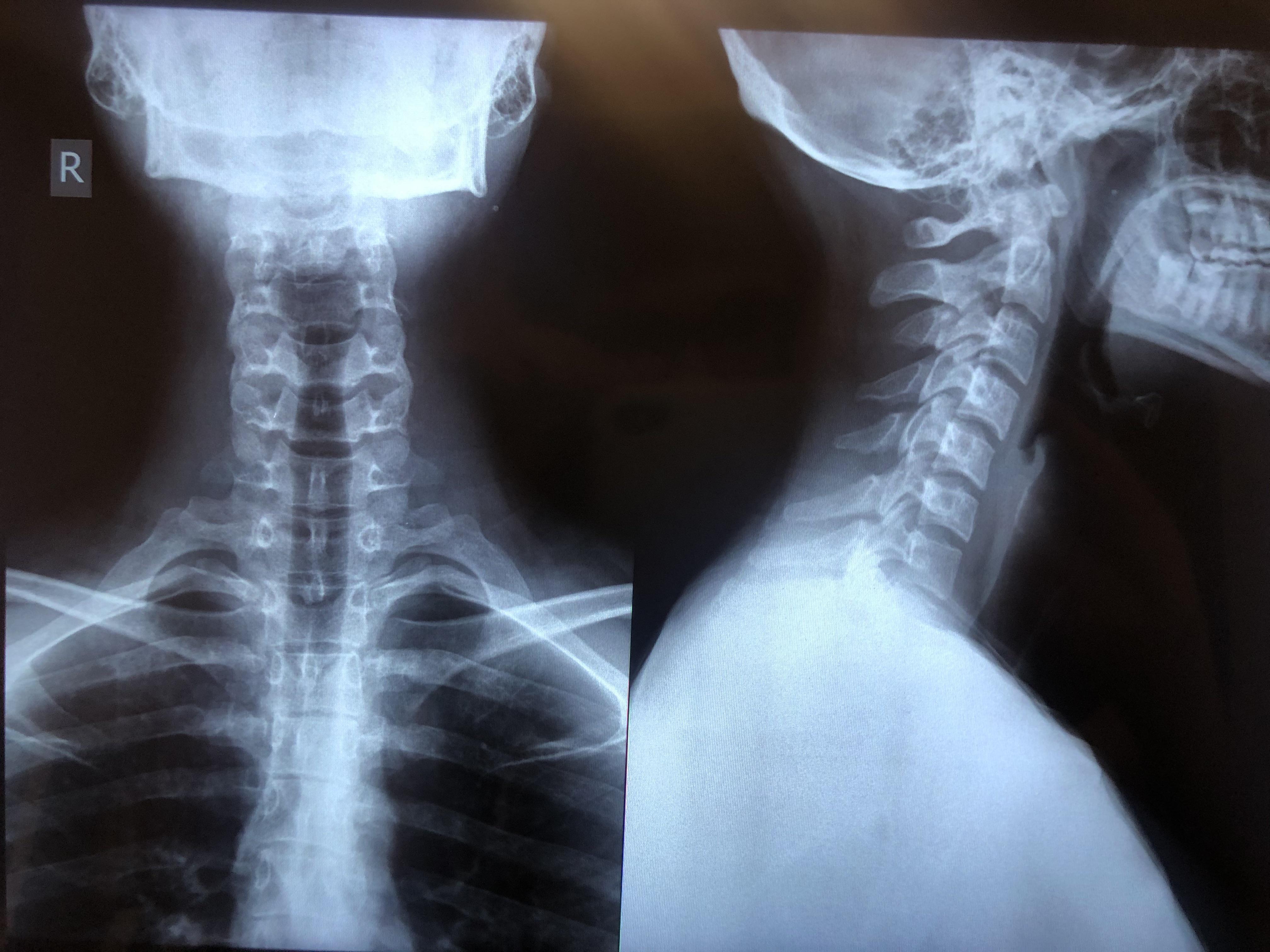 X Ray of my c.spine, thoughts? | Scrolller