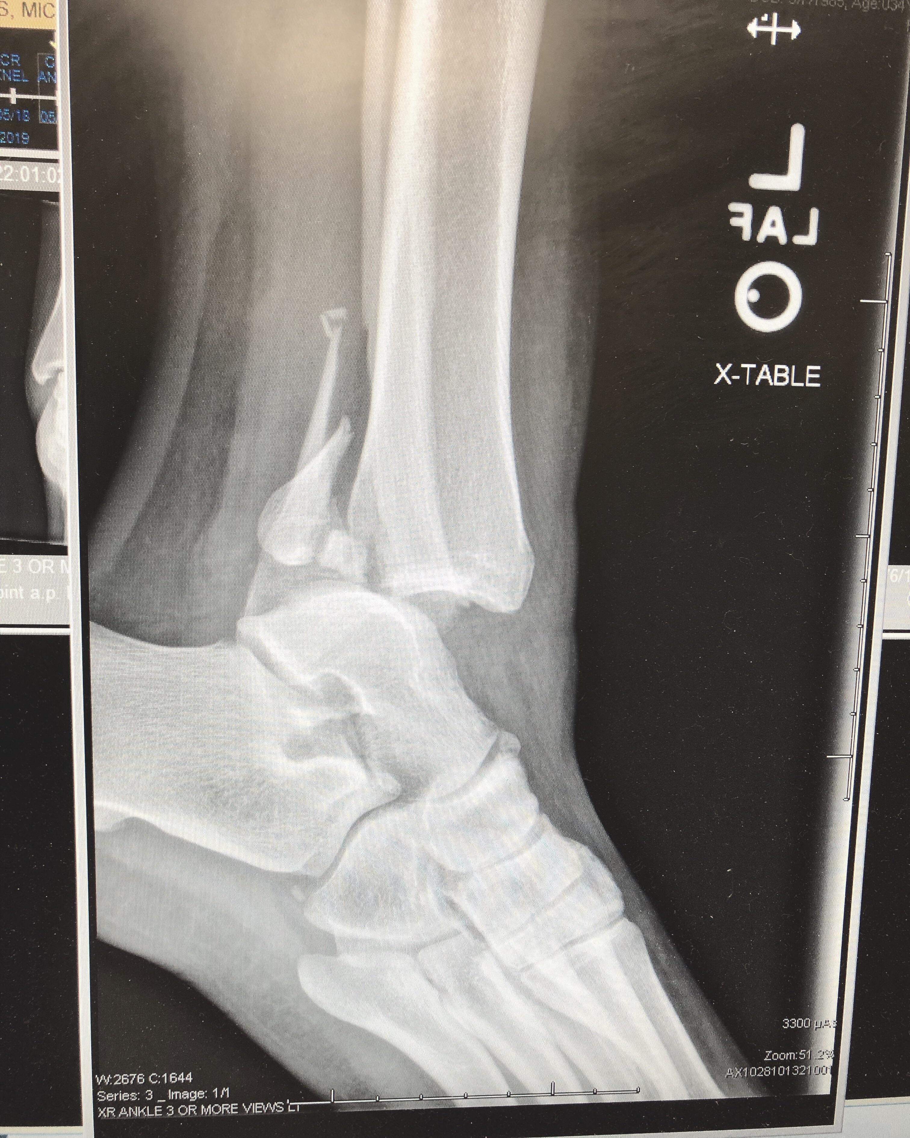 X-ray of my left ankle | Scrolller