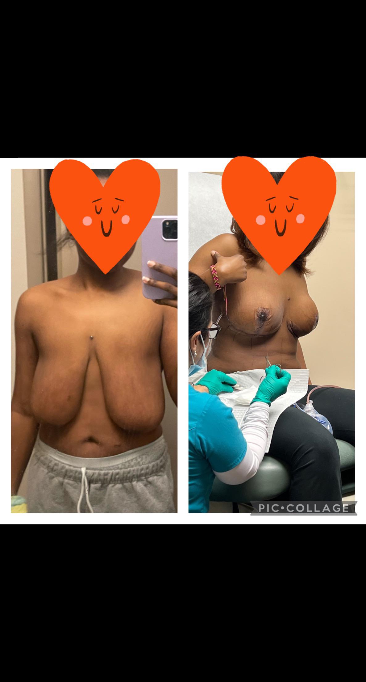 2 Days Post Op I Lost 135lbs So I Needed A Reduction Bad Wondering 6414
