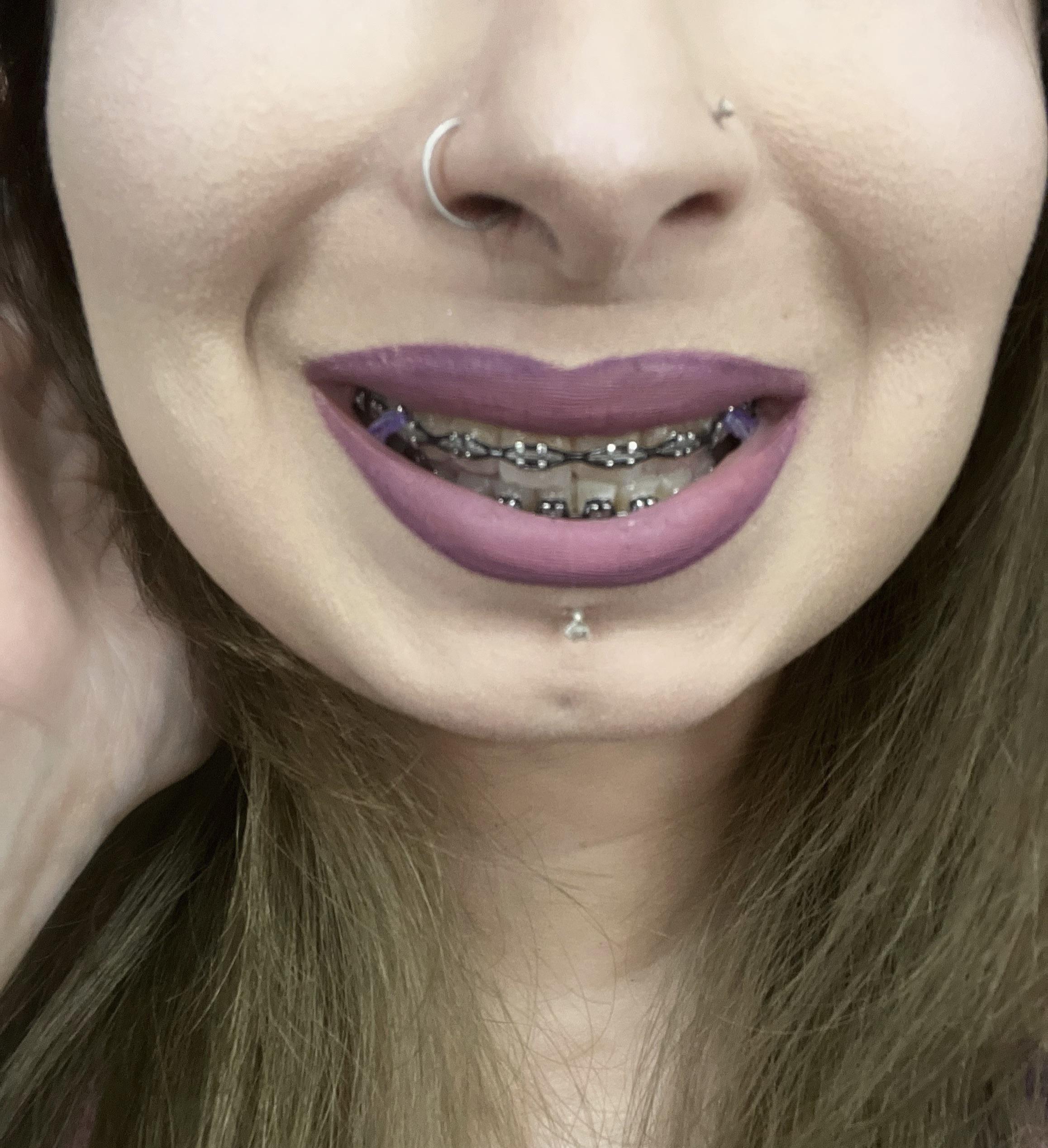 Braces, bands, piercings and lipstick😜 | Scrolller