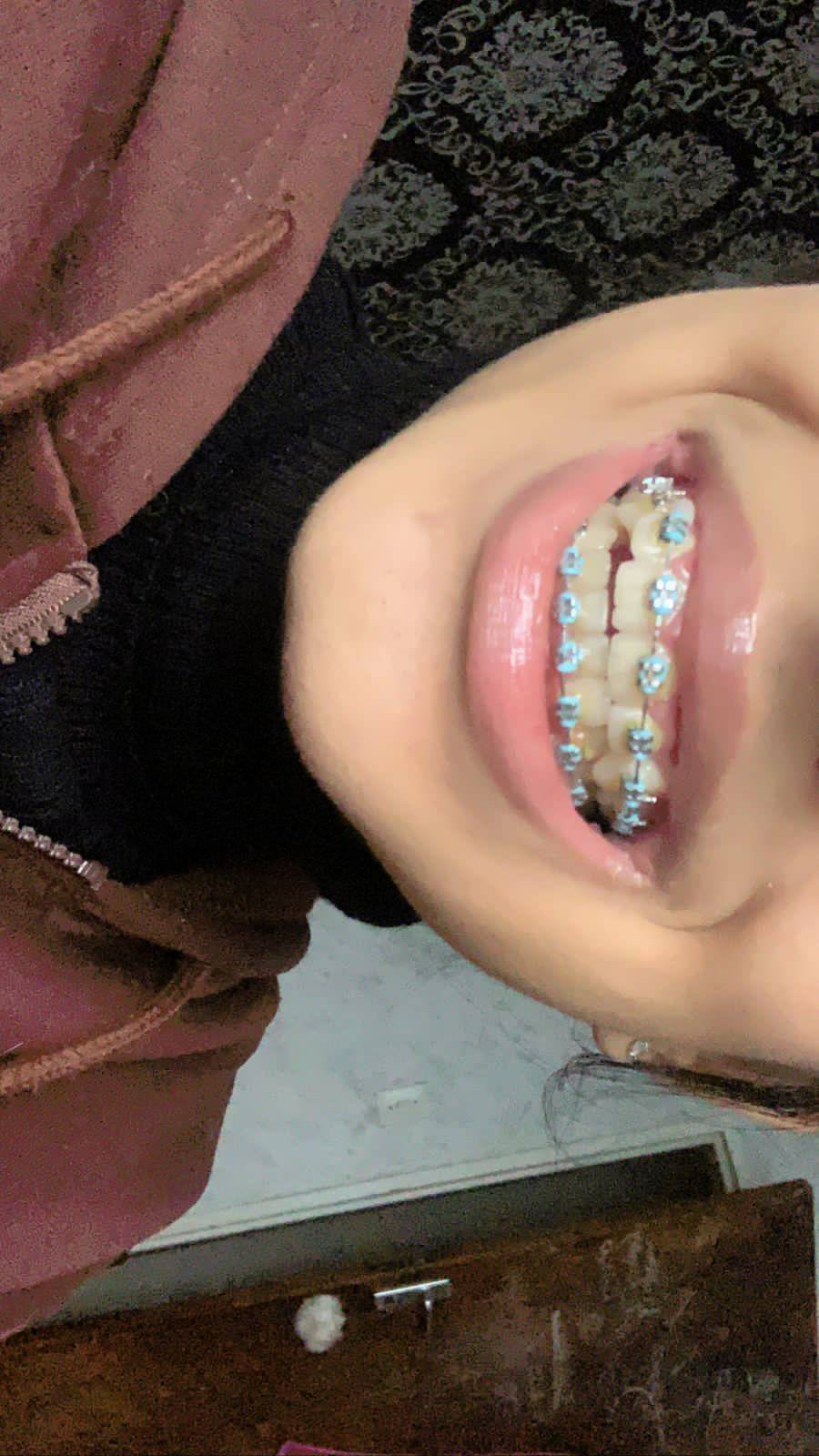 Gf braces, dm for more | Scrolller