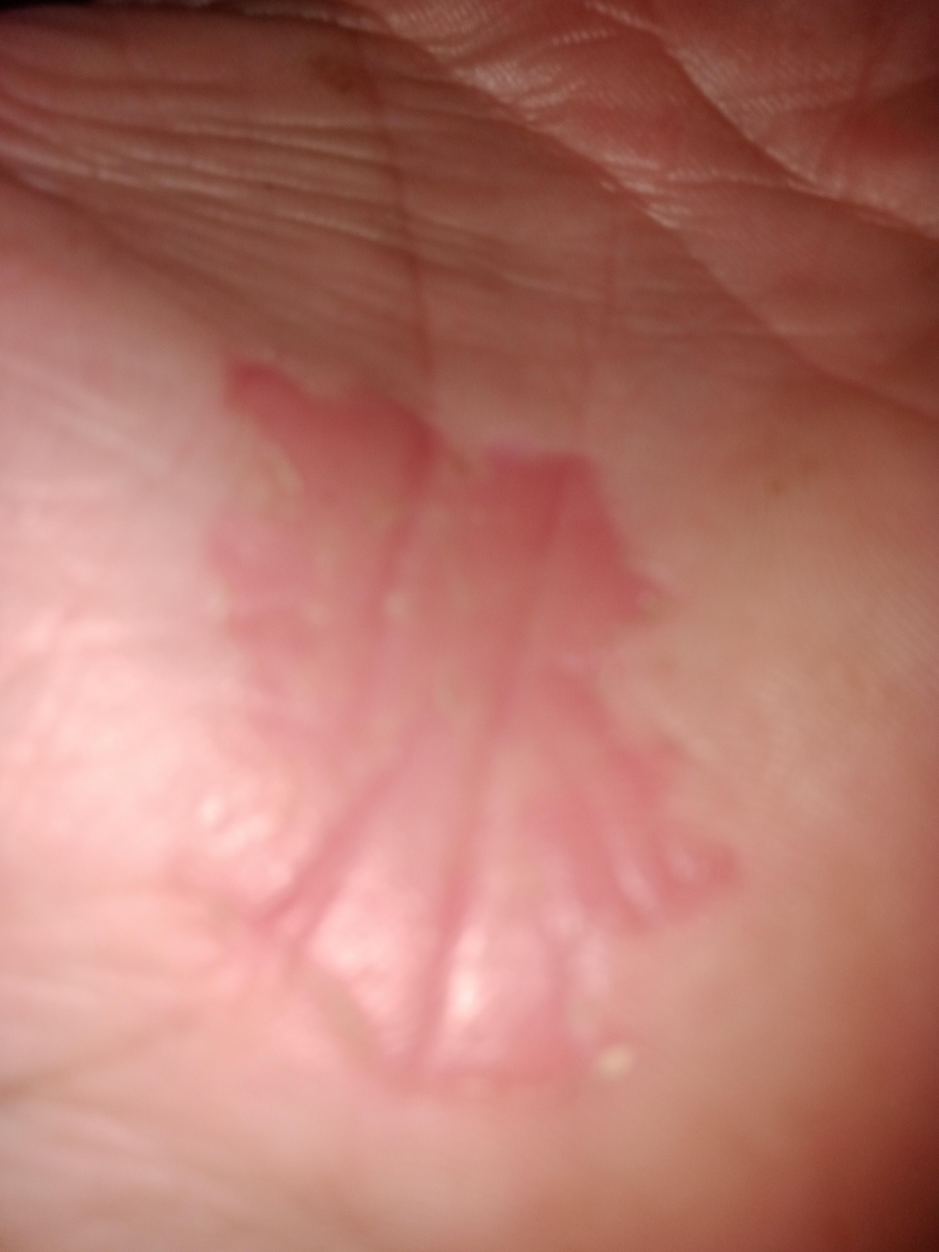 Hand scar. | Scrolller