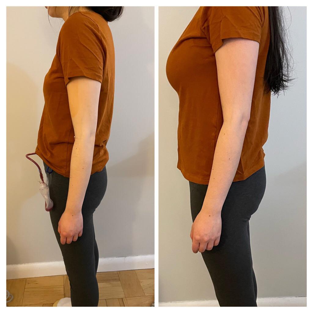 Post-Op Day Zero from my Lollipop reduction!! ~0.9 lbs removed from each breast!! | Scrolller