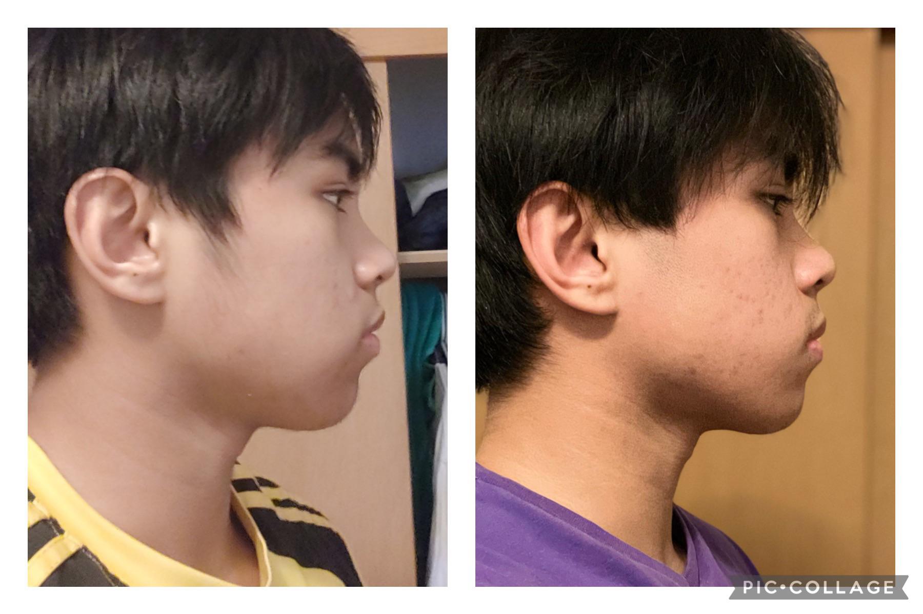 1 year mewing and fat loss results | Scrolller