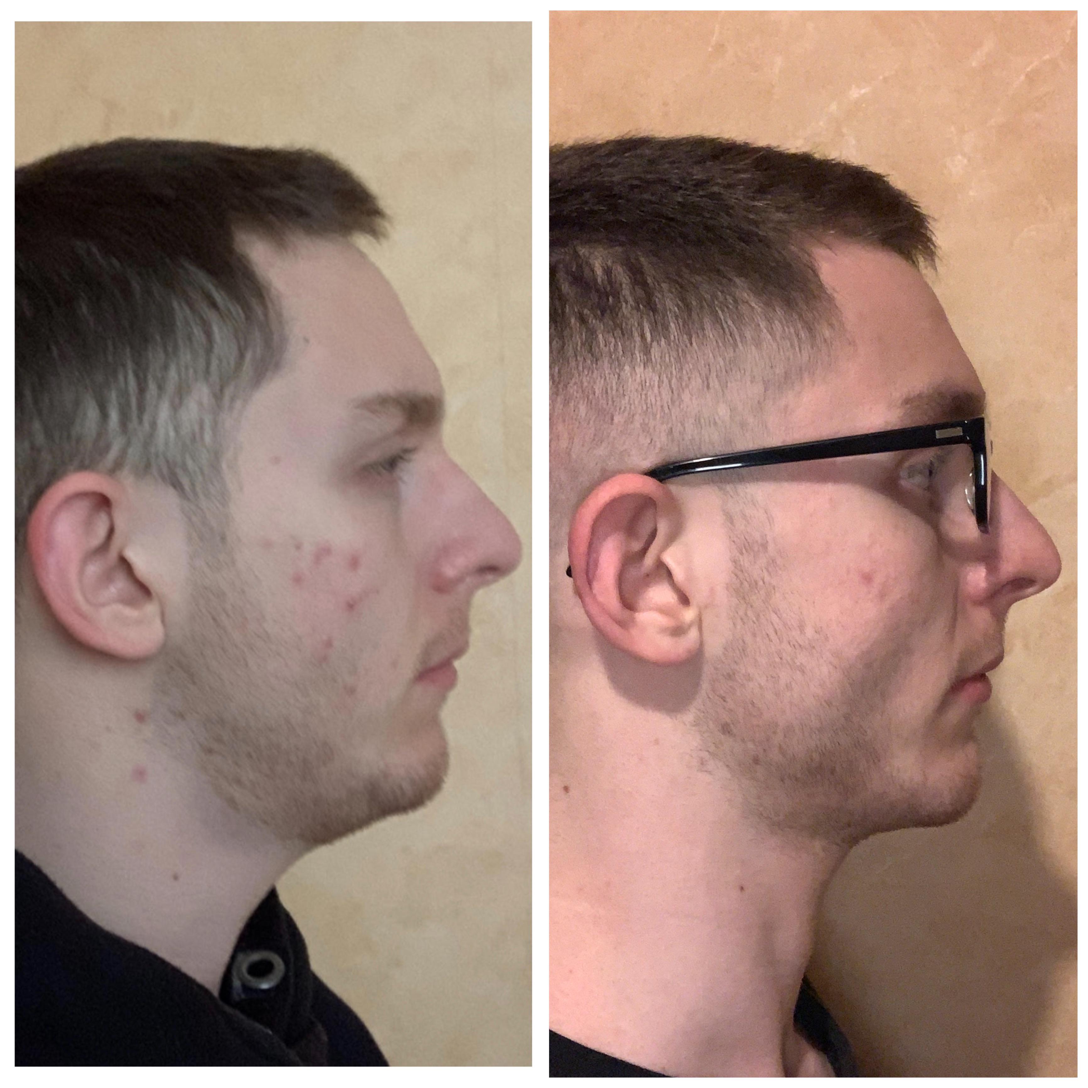 1 Year of mewing | Scrolller