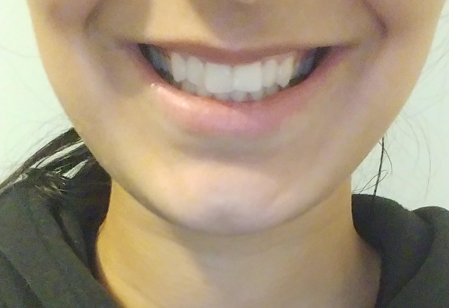 [20 F] small teeth, crowded front left tooth, negative spacing, what procedures should I look ...