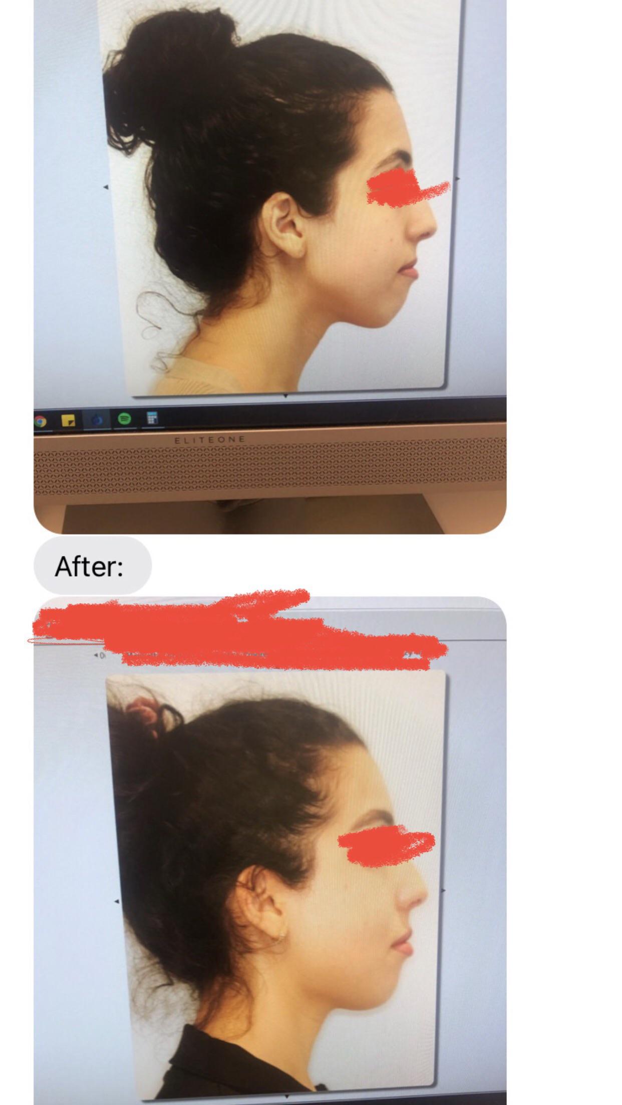 (22 F) 3 months mewing update: | Scrolller