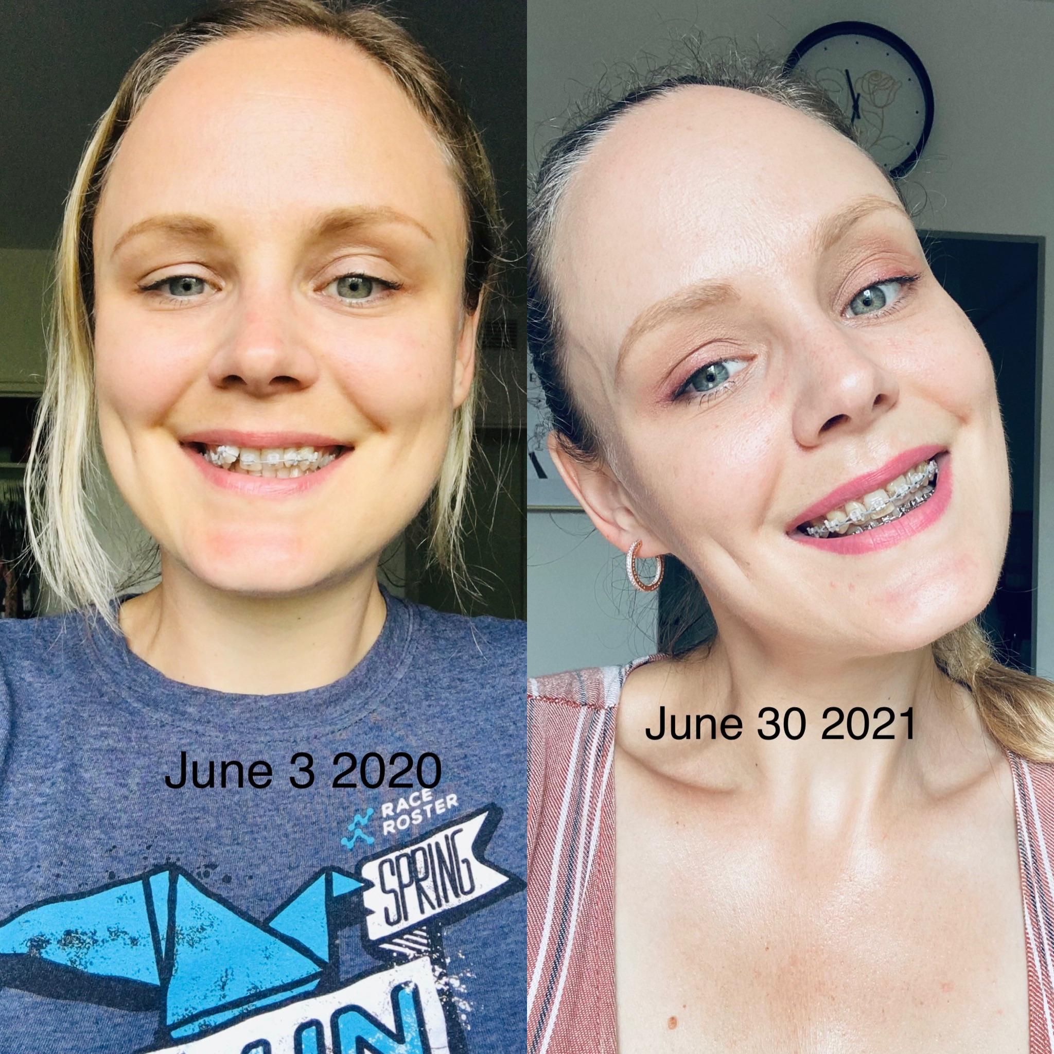 33/f. One year progress! Getting elastics next appointment... 😬 | Scrolller