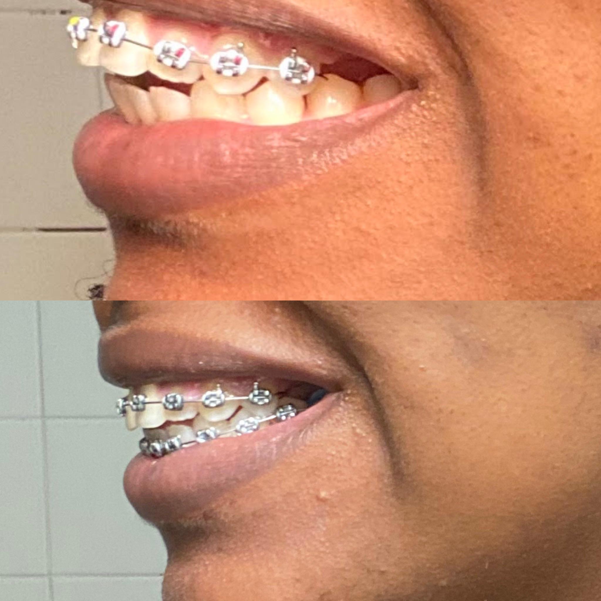 4 months progress! Open bite almost closed | Scrolller
