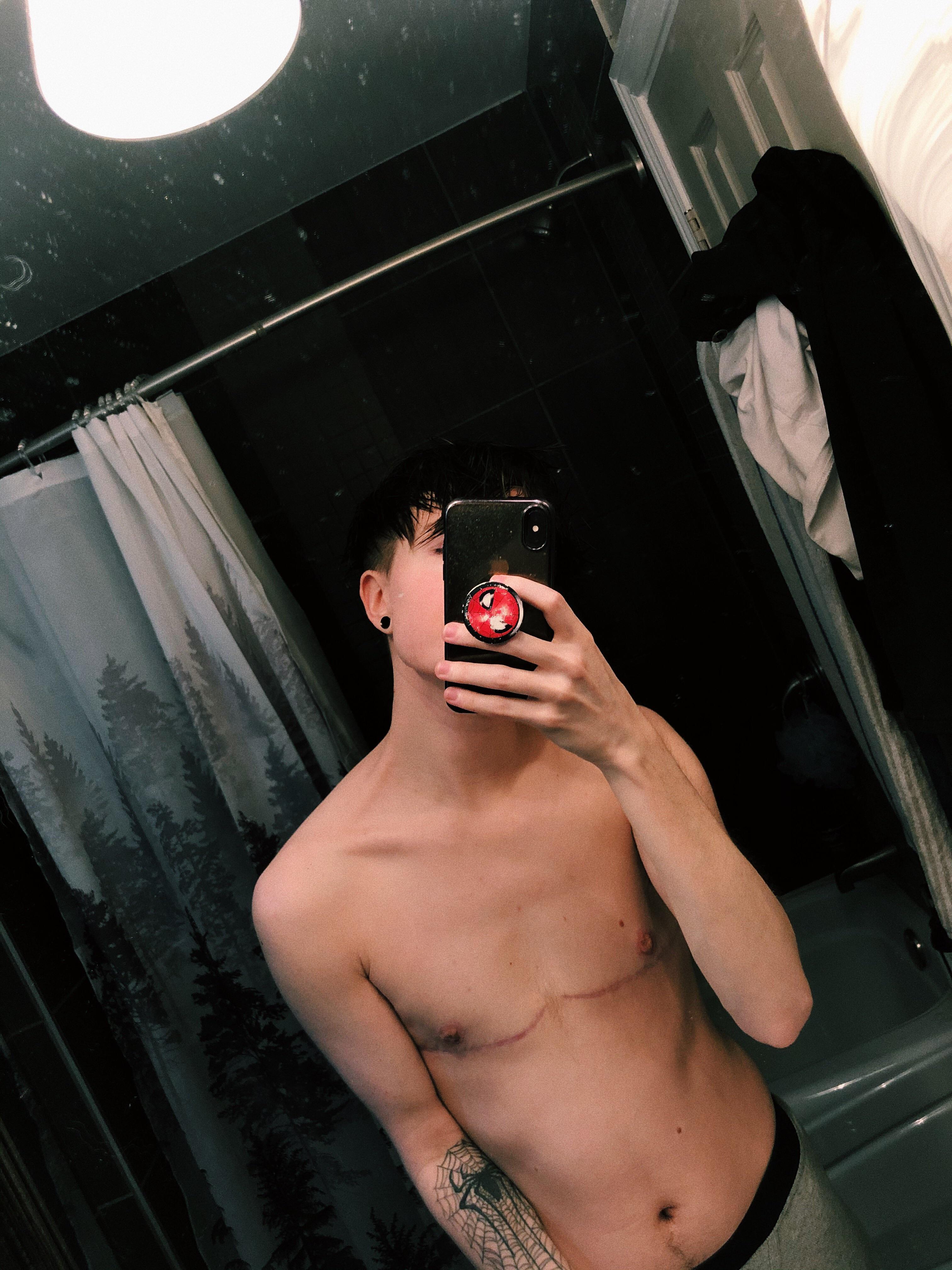 5 months, 8 days post op :) | Scrolller