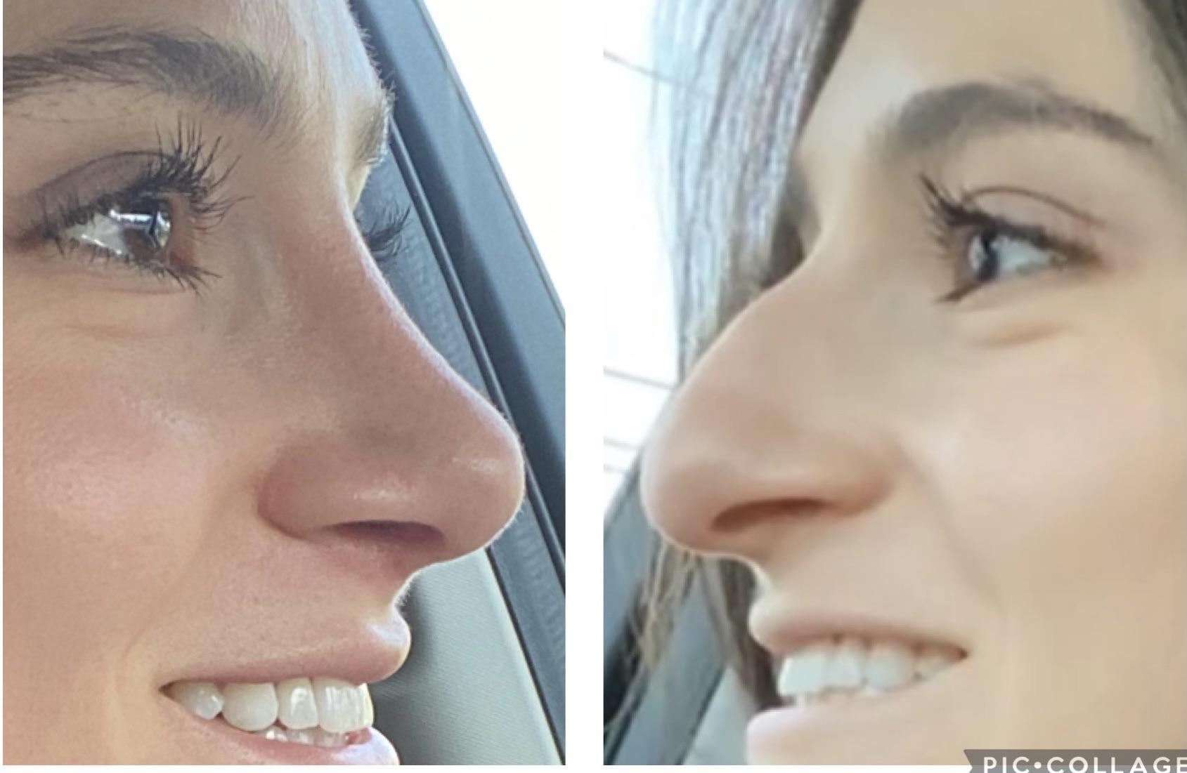 5 months post rhinoplasty | Scrolller