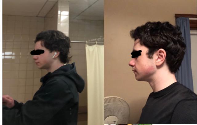 5 months progress of mewing (before: left, after: right) | Scrolller