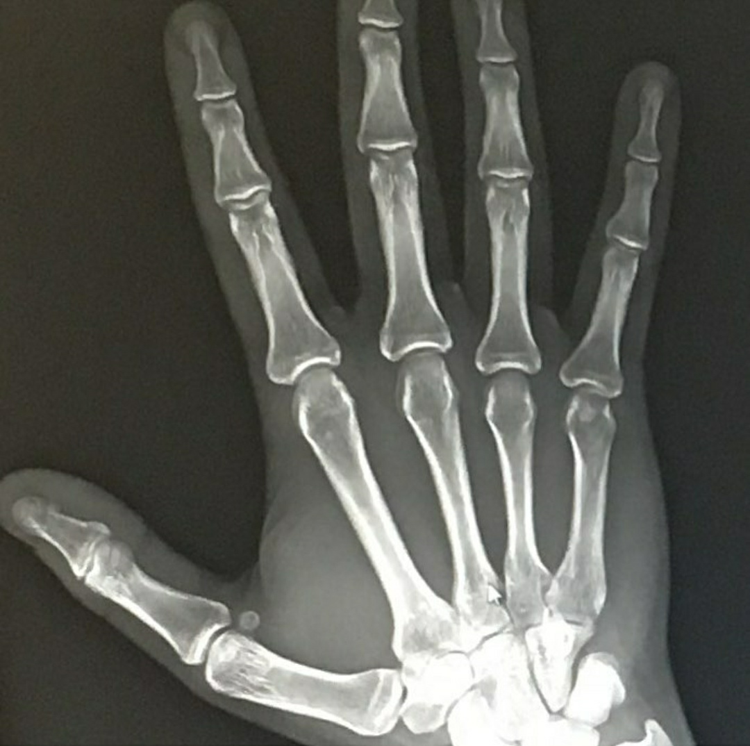 A healthy hand full of calcium | Scrolller
