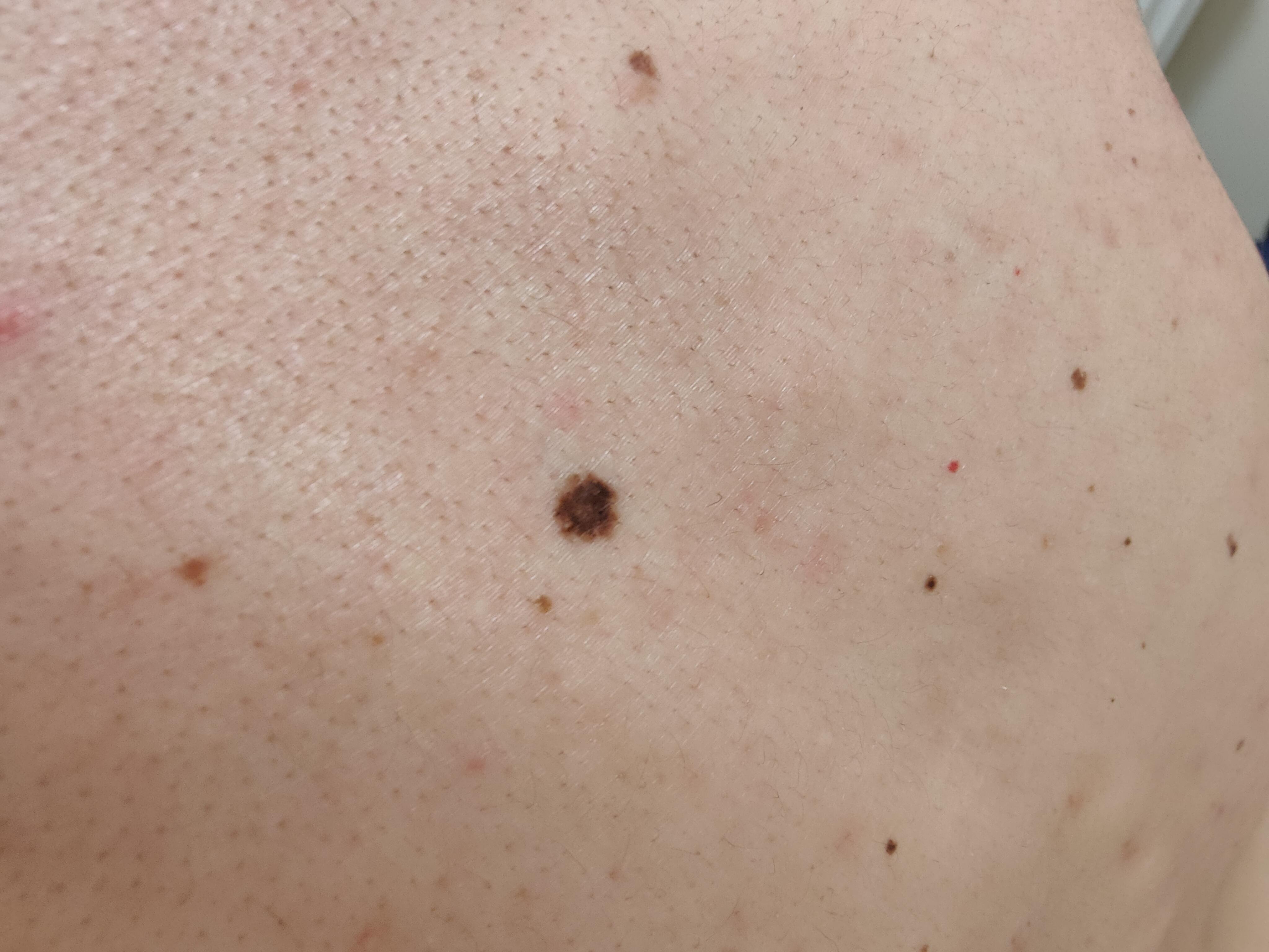 A mole that I noticed a just the last 2/3 years on my back, the size of ... A mole that I noticed a just the last 2/3 years on my back, the size of ...