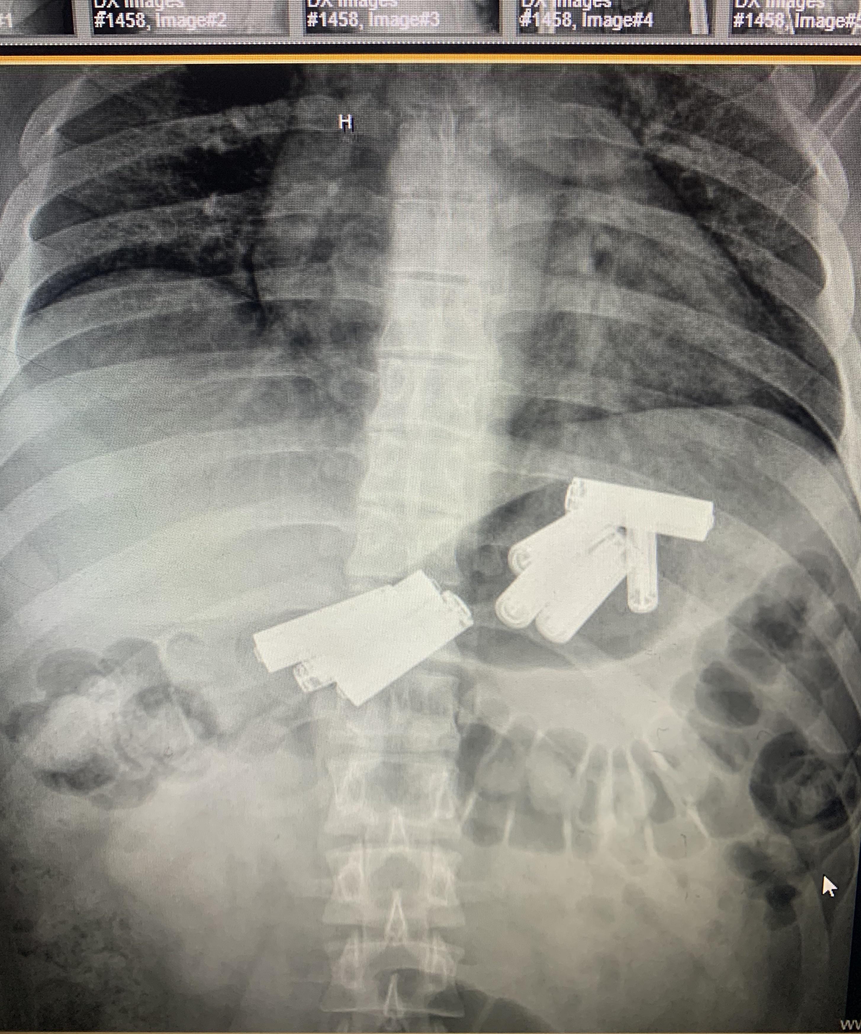 Abdominal pain | Scrolller