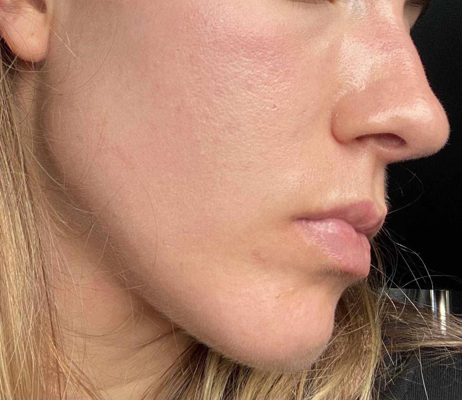 Adapalene and tough texture - help! | Scrolller