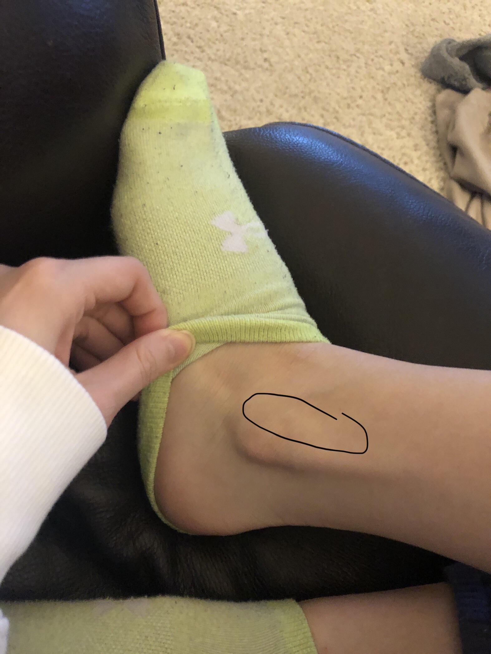 Ankle hurts when I point, flex, and go on releve? (In the circled area) | Scrolller