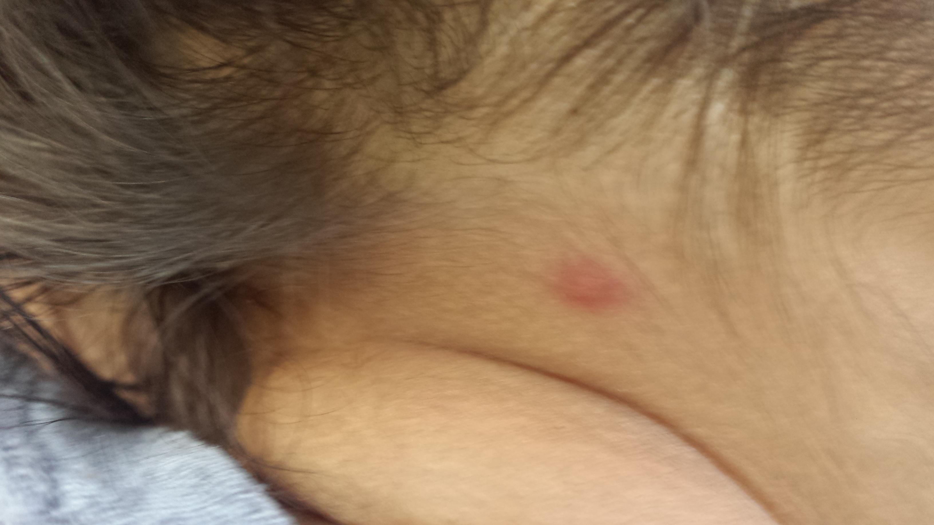 Anyone know if this is an insect bite? | Scrolller