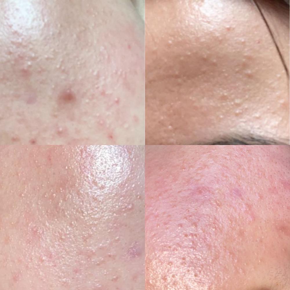 BAD BREAKOUTS: Fungal acne? | Scrolller