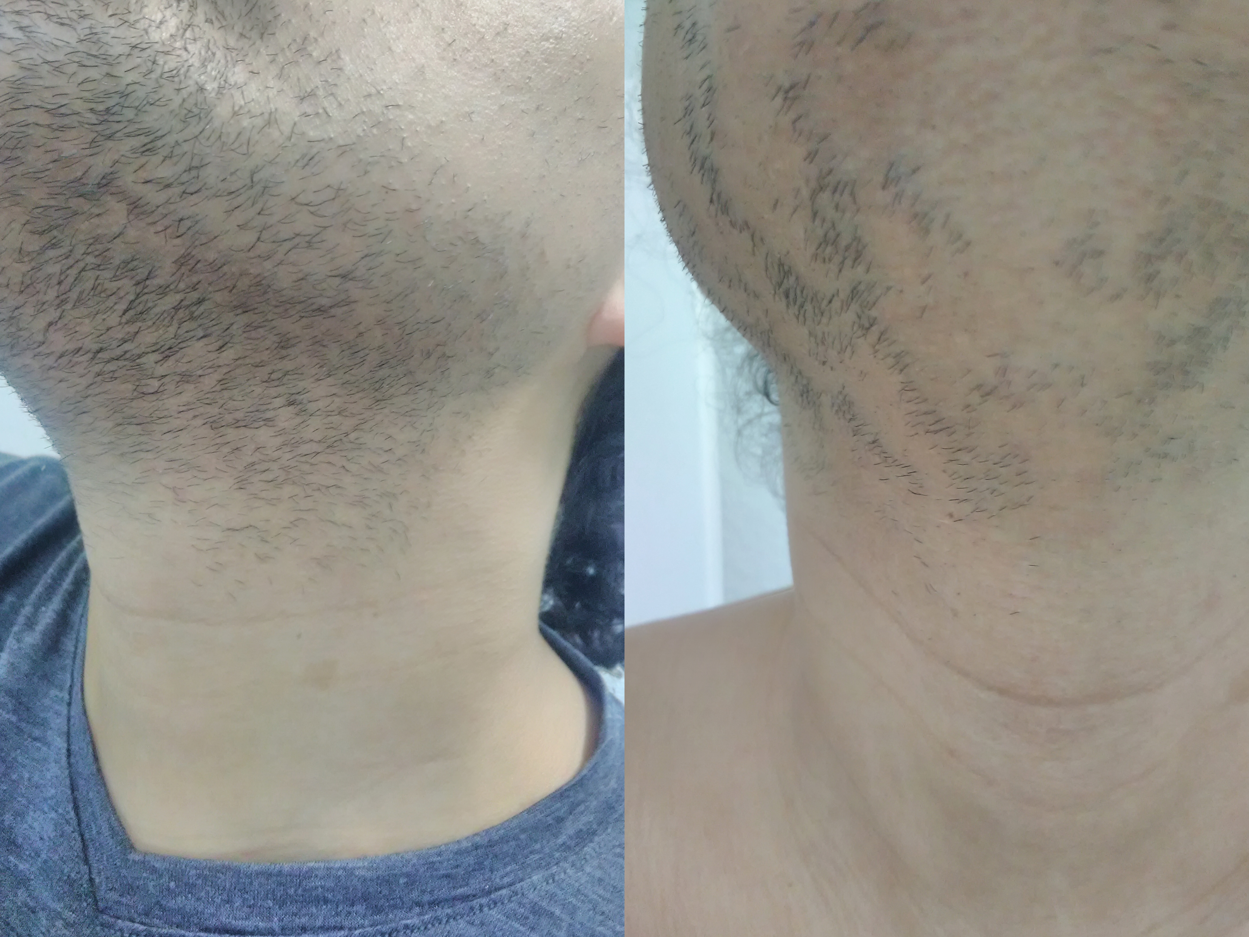 Before / After of my first session of laser beard removal | Scrolller