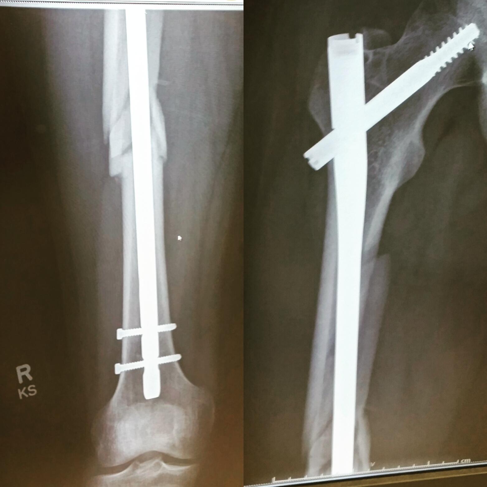 Broke my femur playing Baseball. | Scrolller