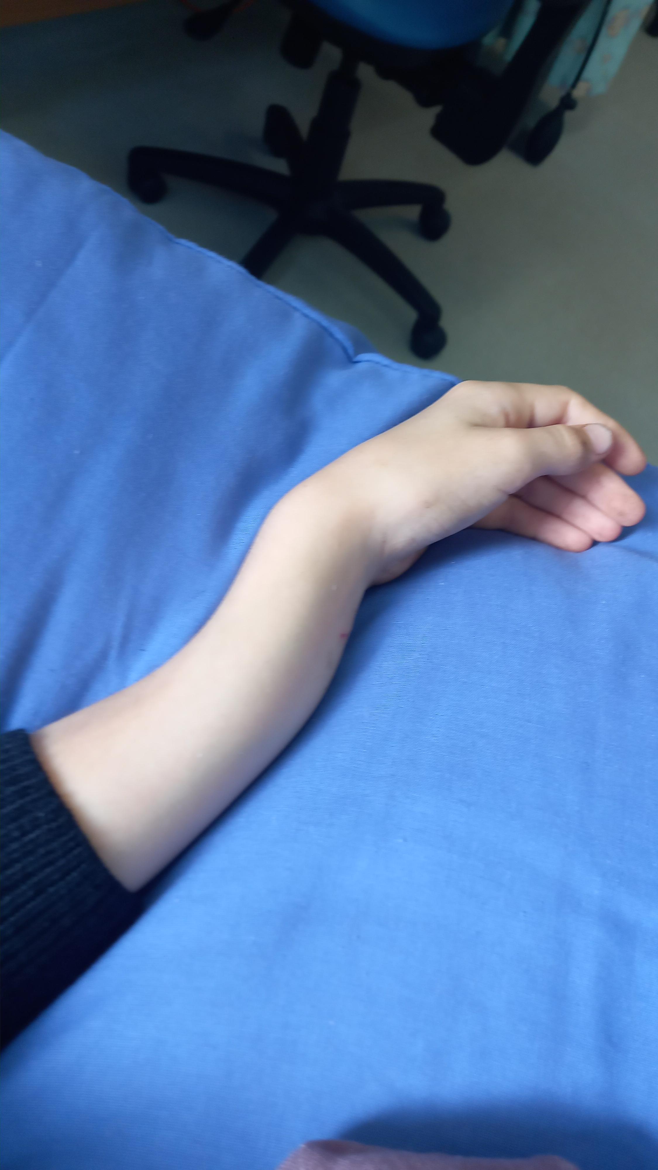 broken arm | Scrolller