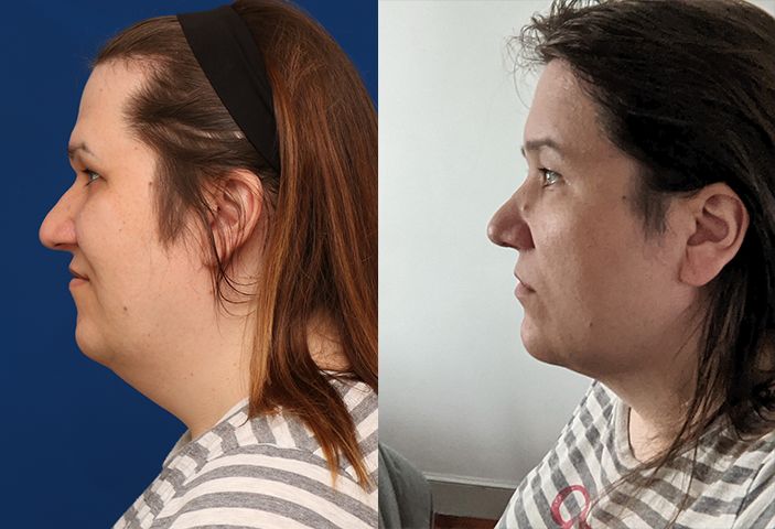 Brow Reduction, Rhinoplasty, Hair Transplant, and Neck Liposuction. 1 year post-op. | Scrolller