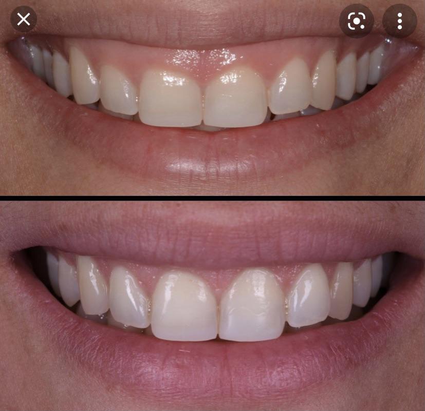 can mewing help correct a gummy smile or reduce gum size a bit? | Scrolller