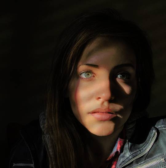 Central heterochromia in female lupus patient. | Scrolller