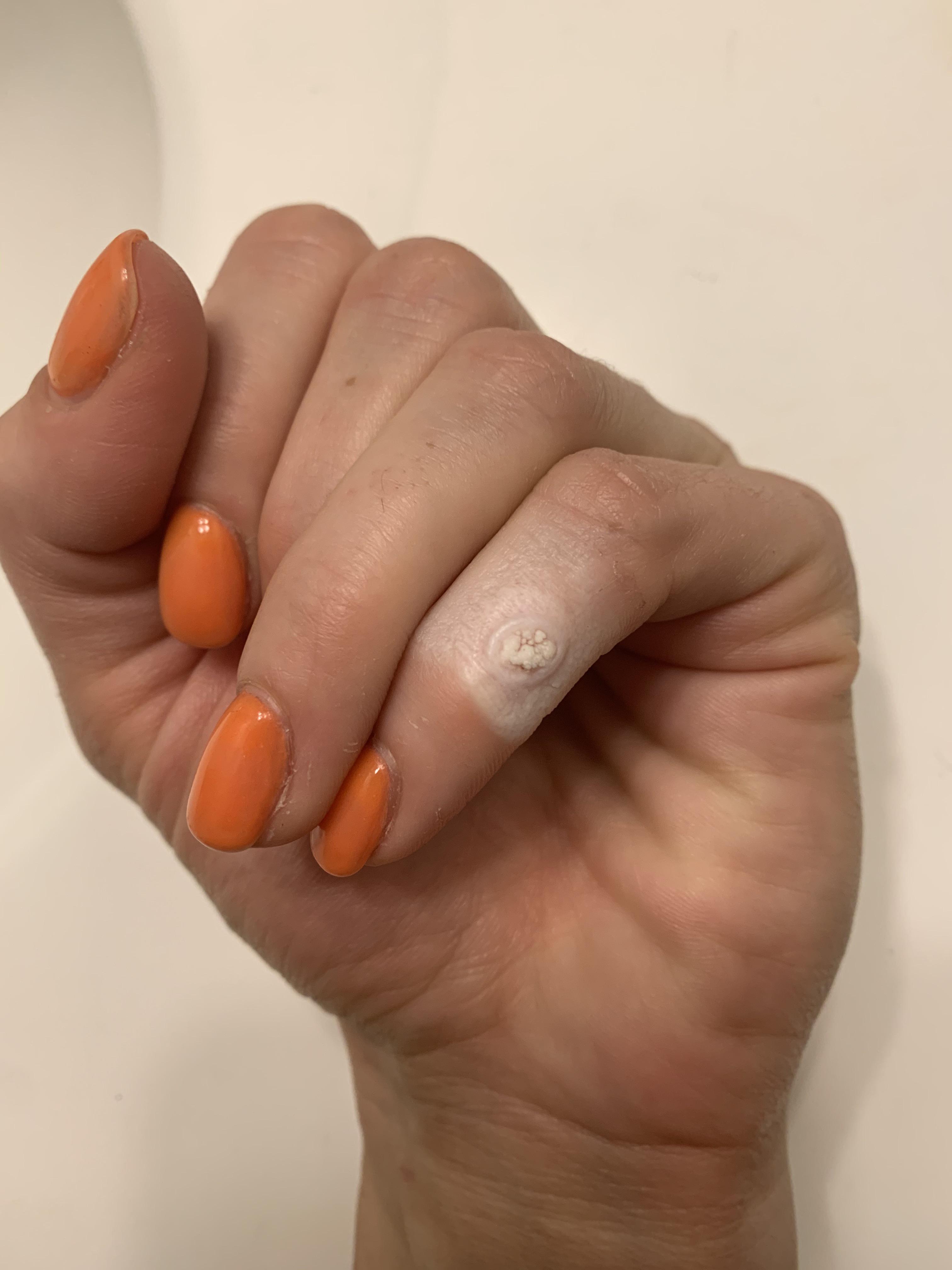 Day 2 of Compound W Strips | Scrolller