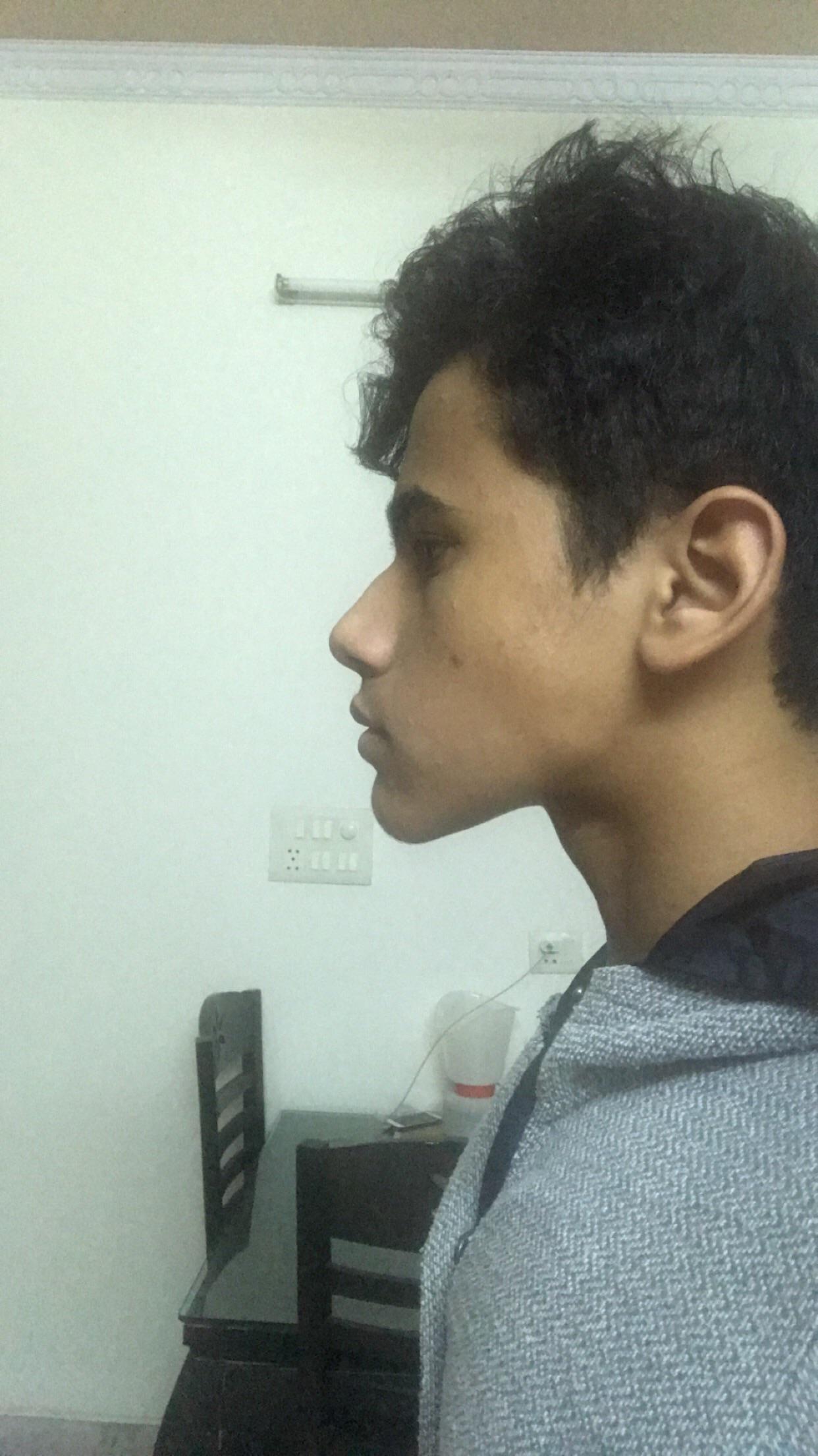 Day one of mewing. Will keep updating every 2 weeks. | Scrolller