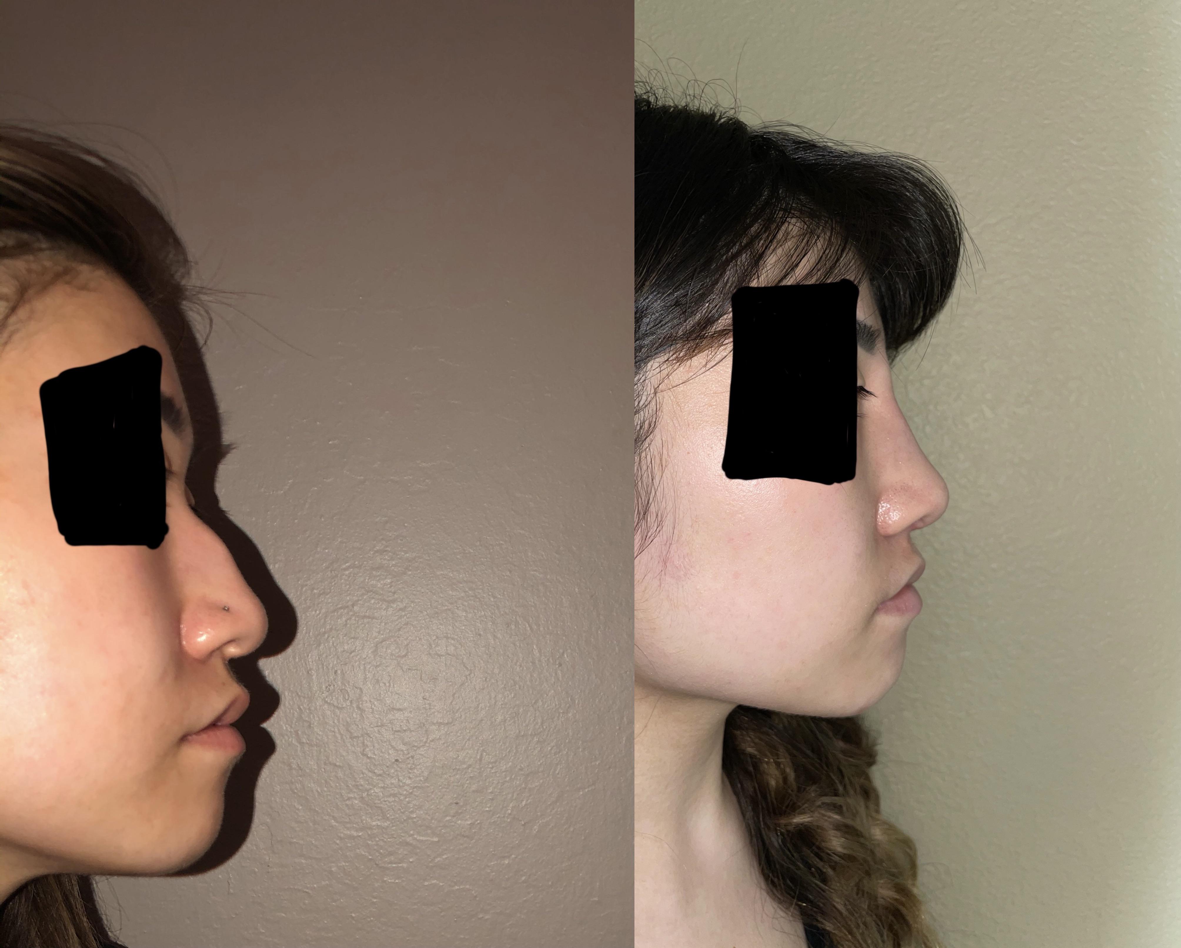 DCF Septorhinoplasty - b&a 1 month post op! | Scrolller