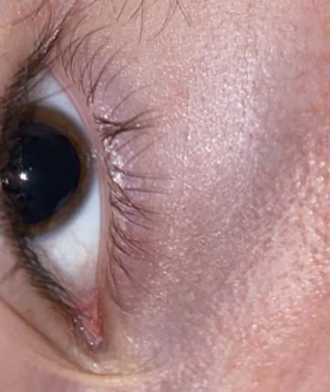 Dilated pupils at eye doctor + DXM | Scrolller