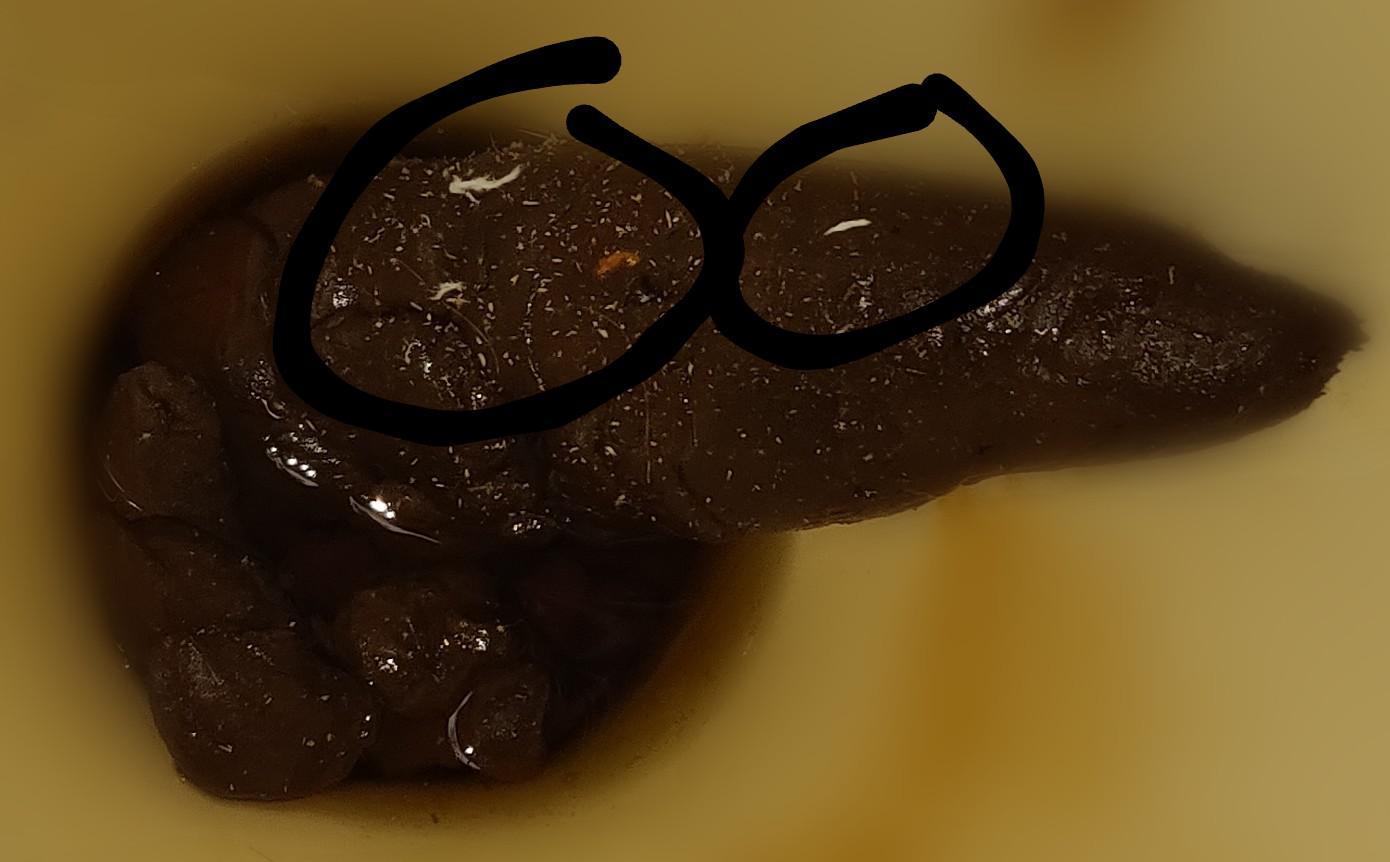 Does anyone know what's in my poop? | Scrolller