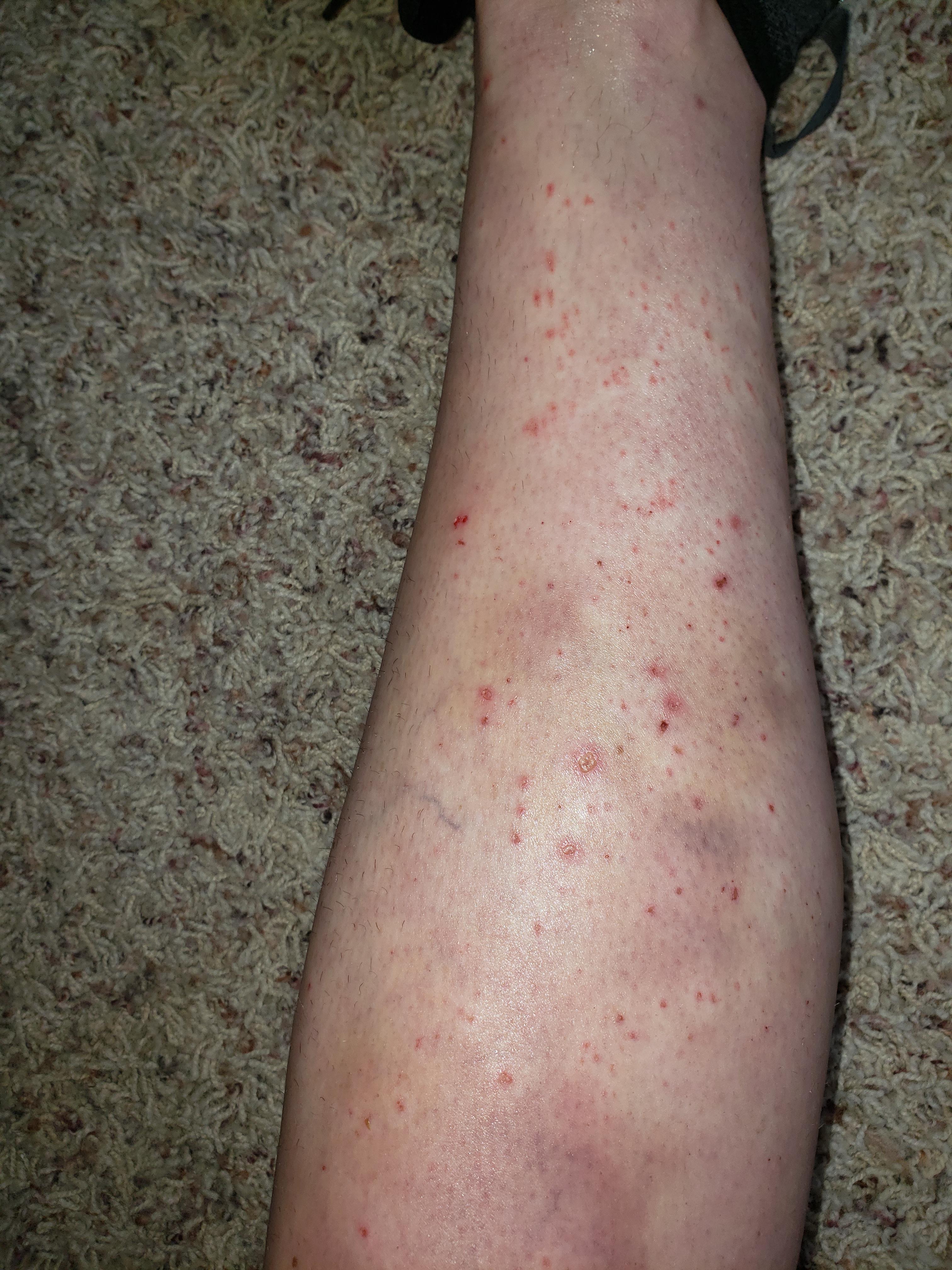 Does this look like Folliculitis? | Scrolller