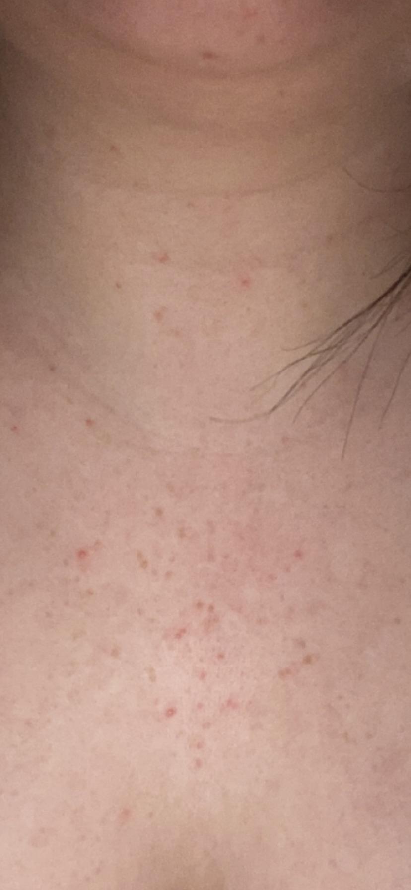 Does this look like folliculitis/fungal acne | Scrolller