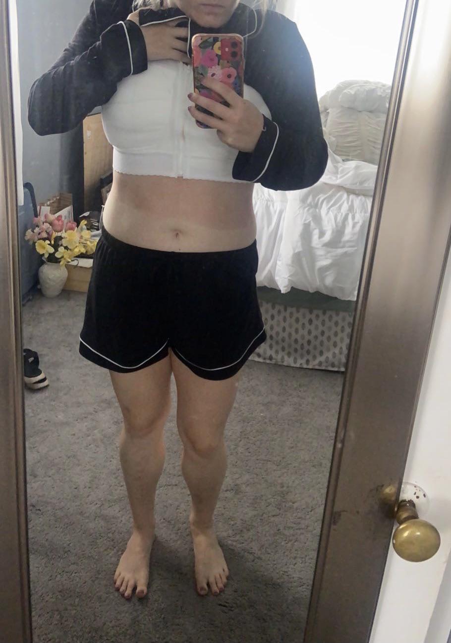 Few hours post op! I feel good! Should I be using ice yet? | Scrolller