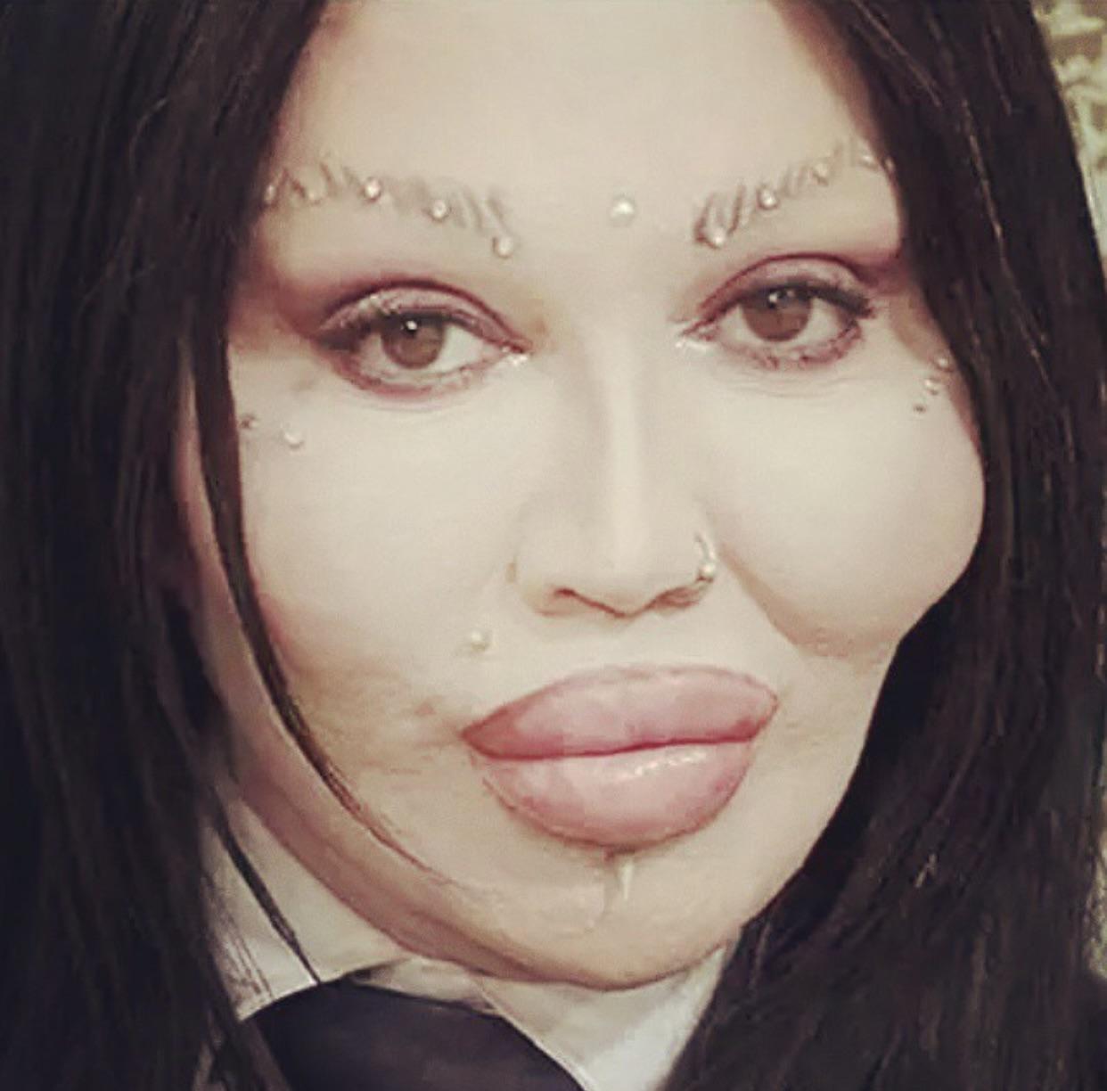 Filler nightmares | Scrolller