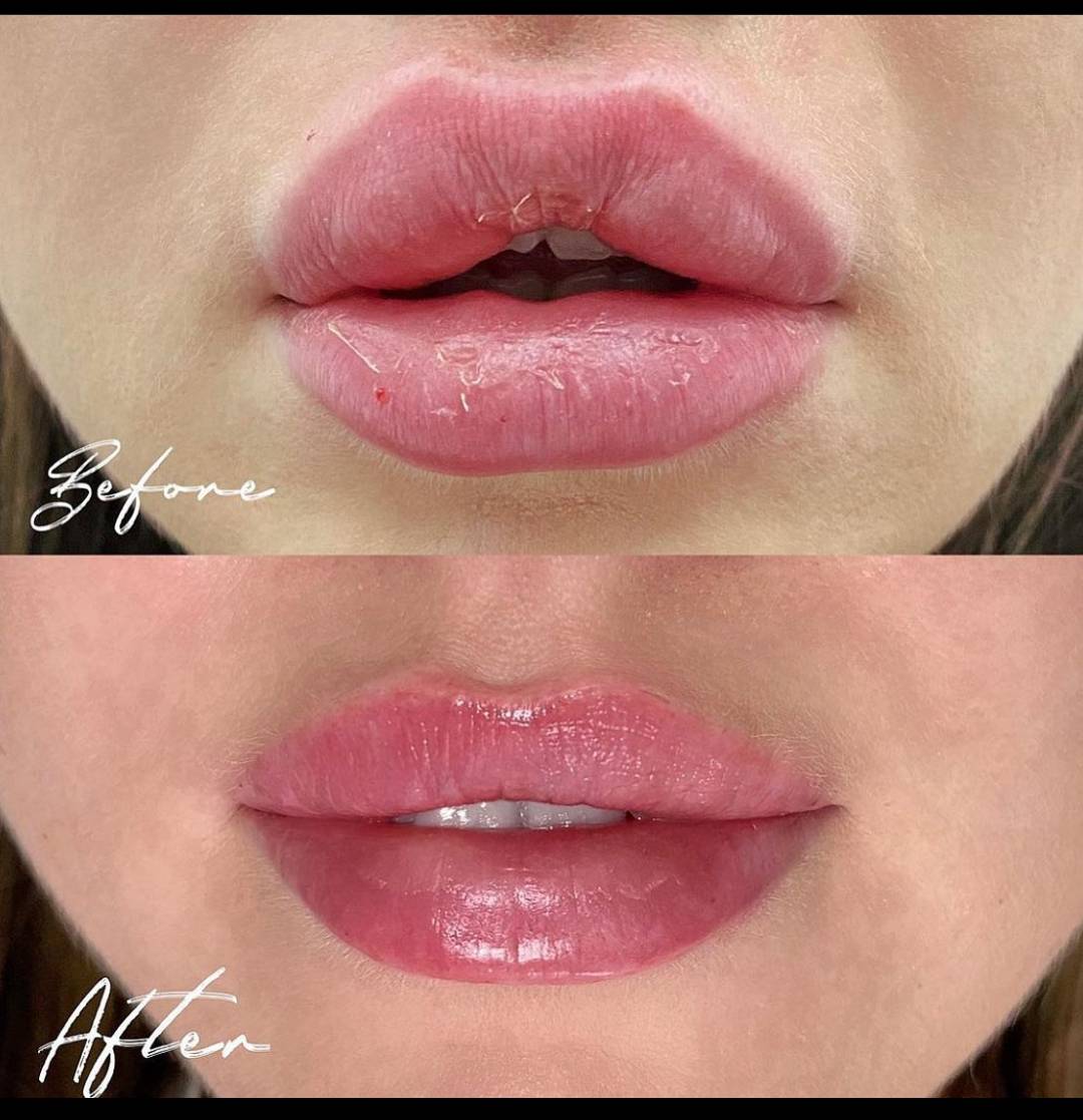 Fixed lip injections | Scrolller