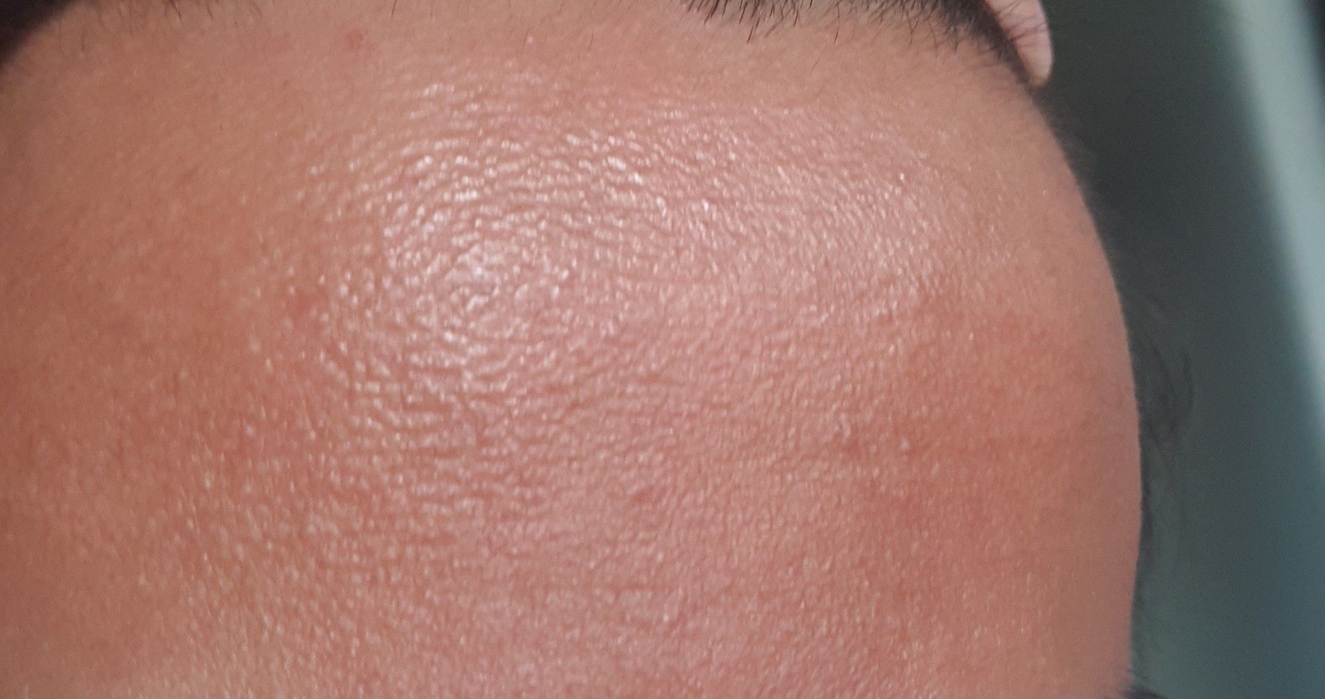 Folliculitis or Milia? | Scrolller