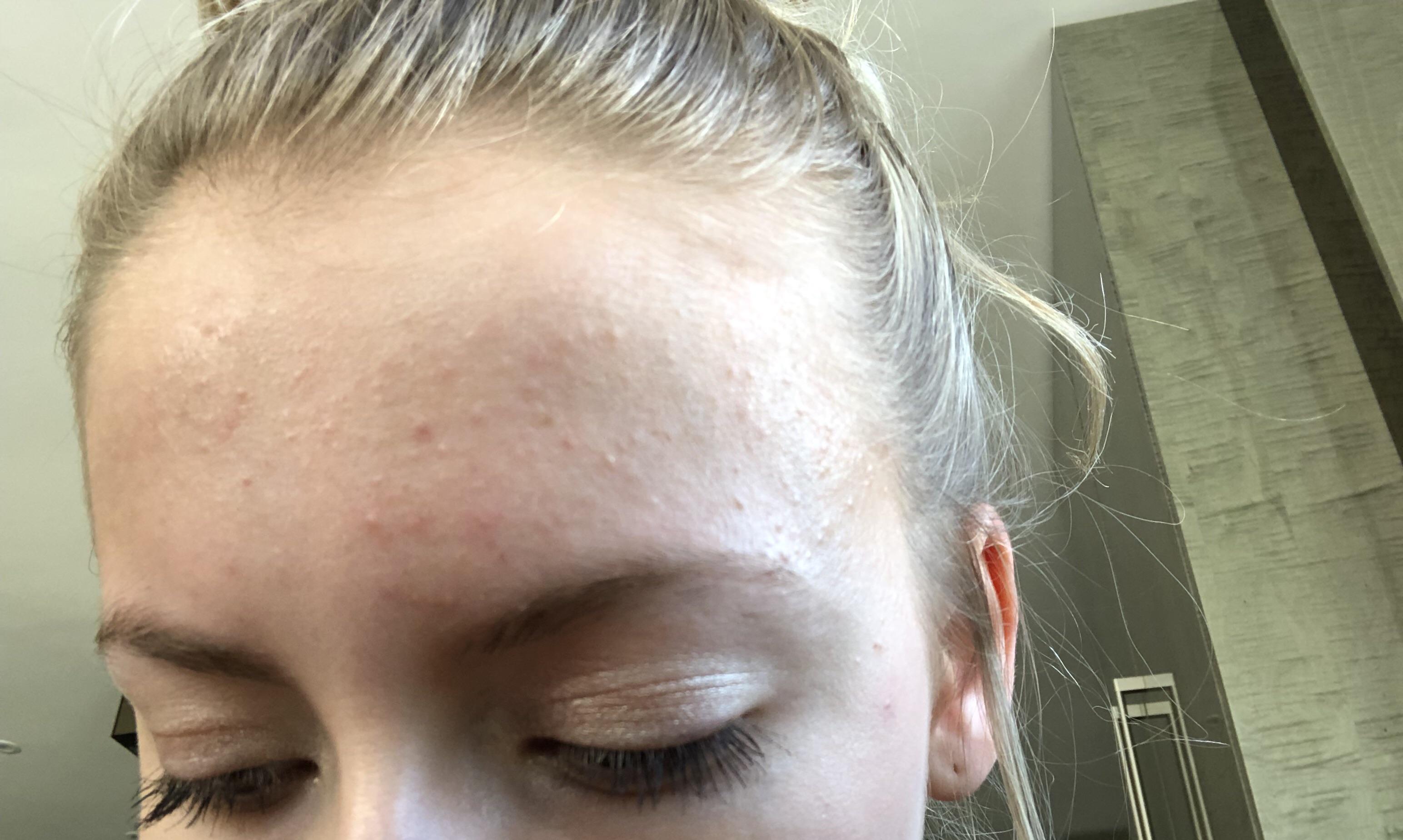 Forehead suddenly covered in tiny bumps. Does this look like fungal acne? | Scrolller