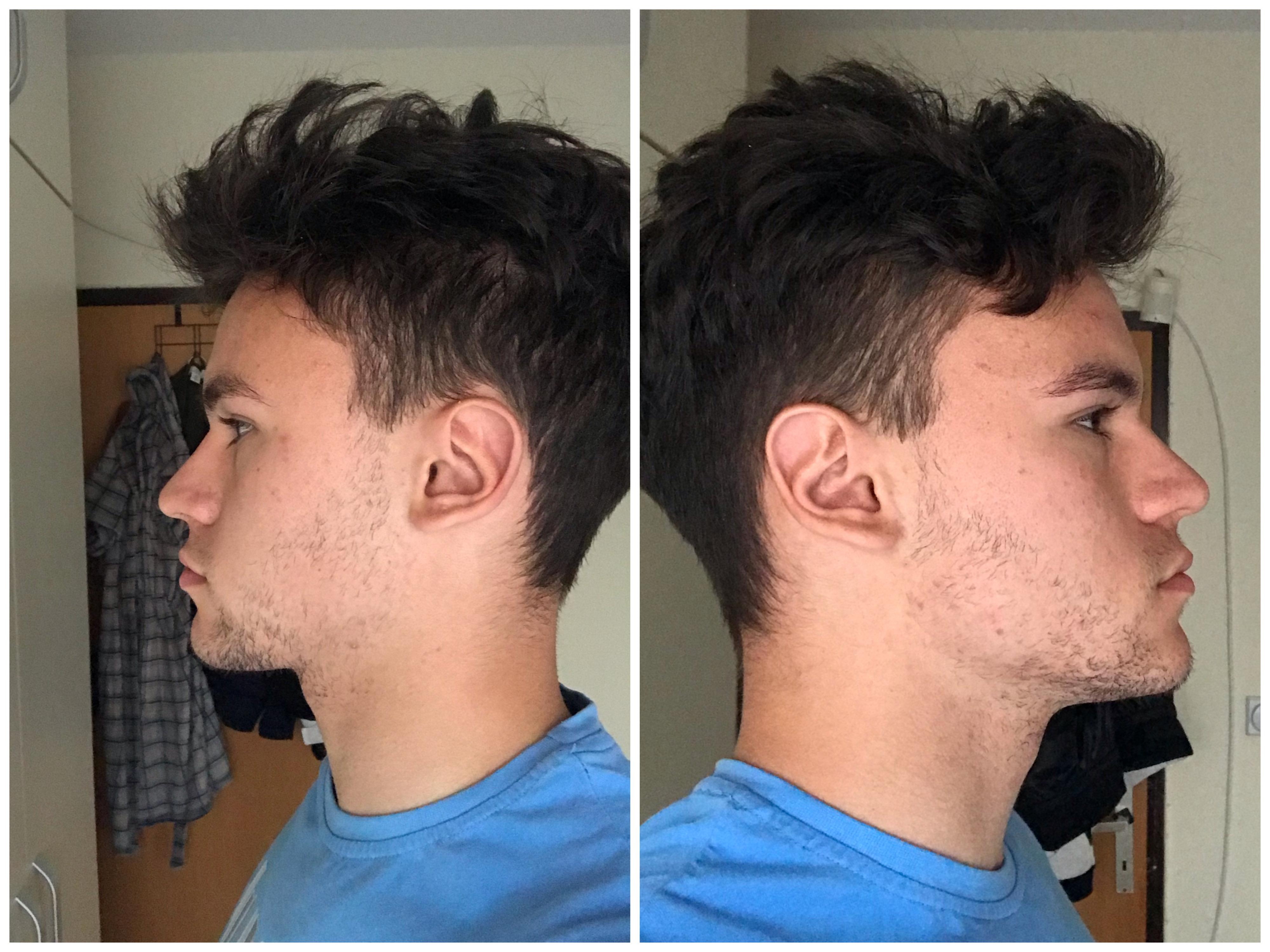 I been mewing for like 4 months, and Im quite satisfied with my right side of face, but my left ...