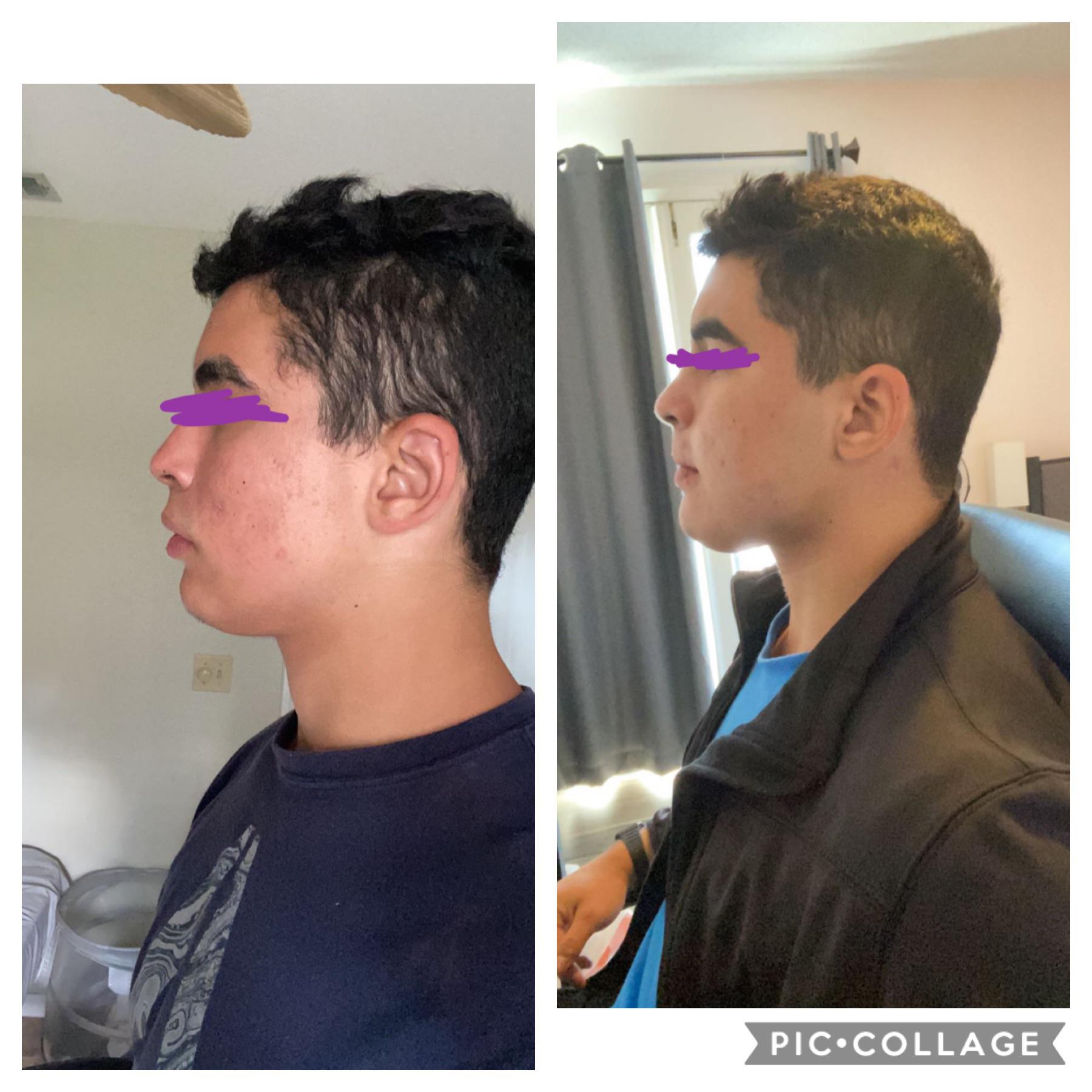 I’m mewing in both photos. Progress from end of April to now so 7 months. | Scrolller