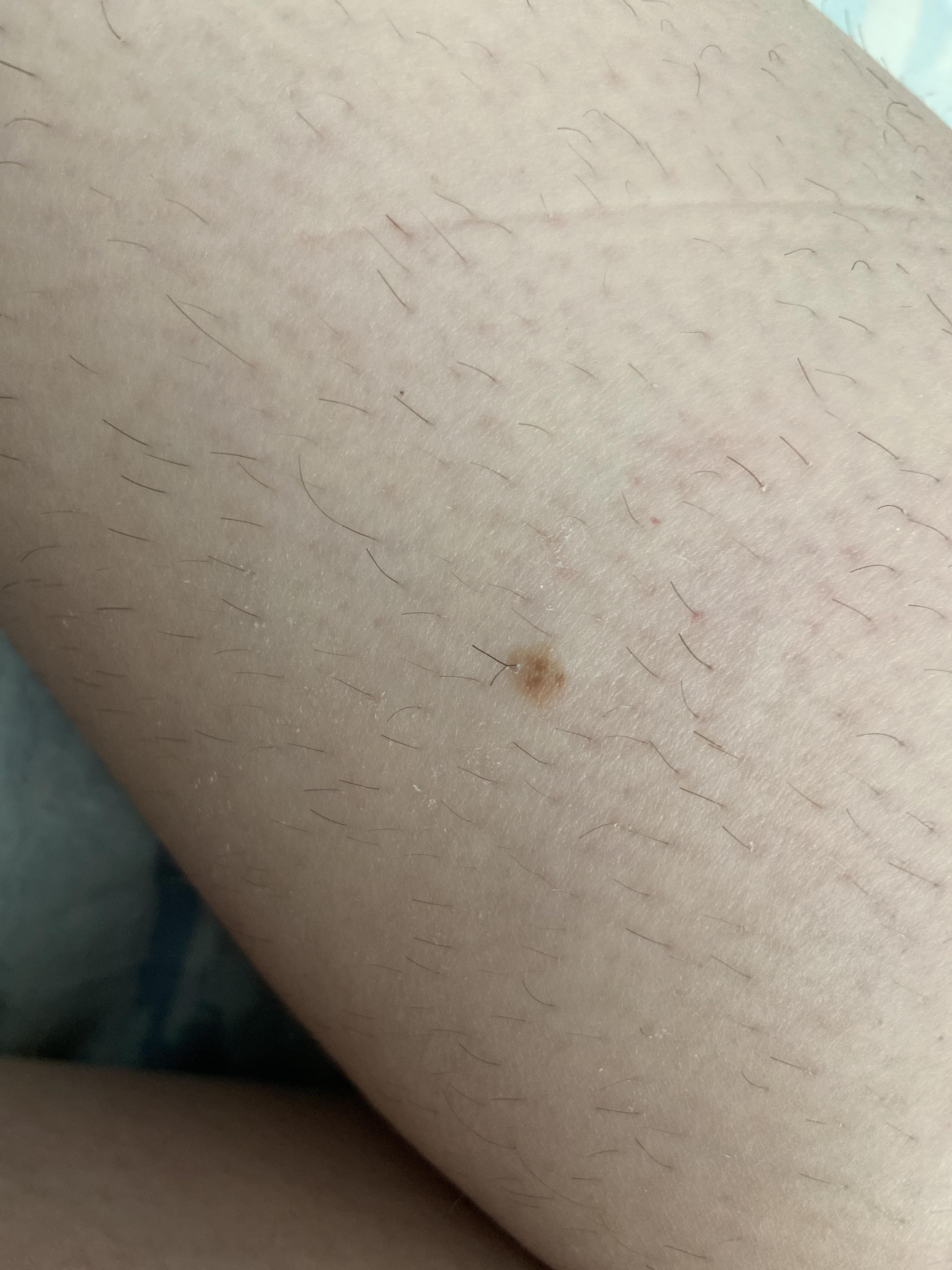 Just noticed this mole on my leg. Does it look abnormal? | Scrolller Just noticed this mole on my leg. Does it look abnormal? | Scrolller